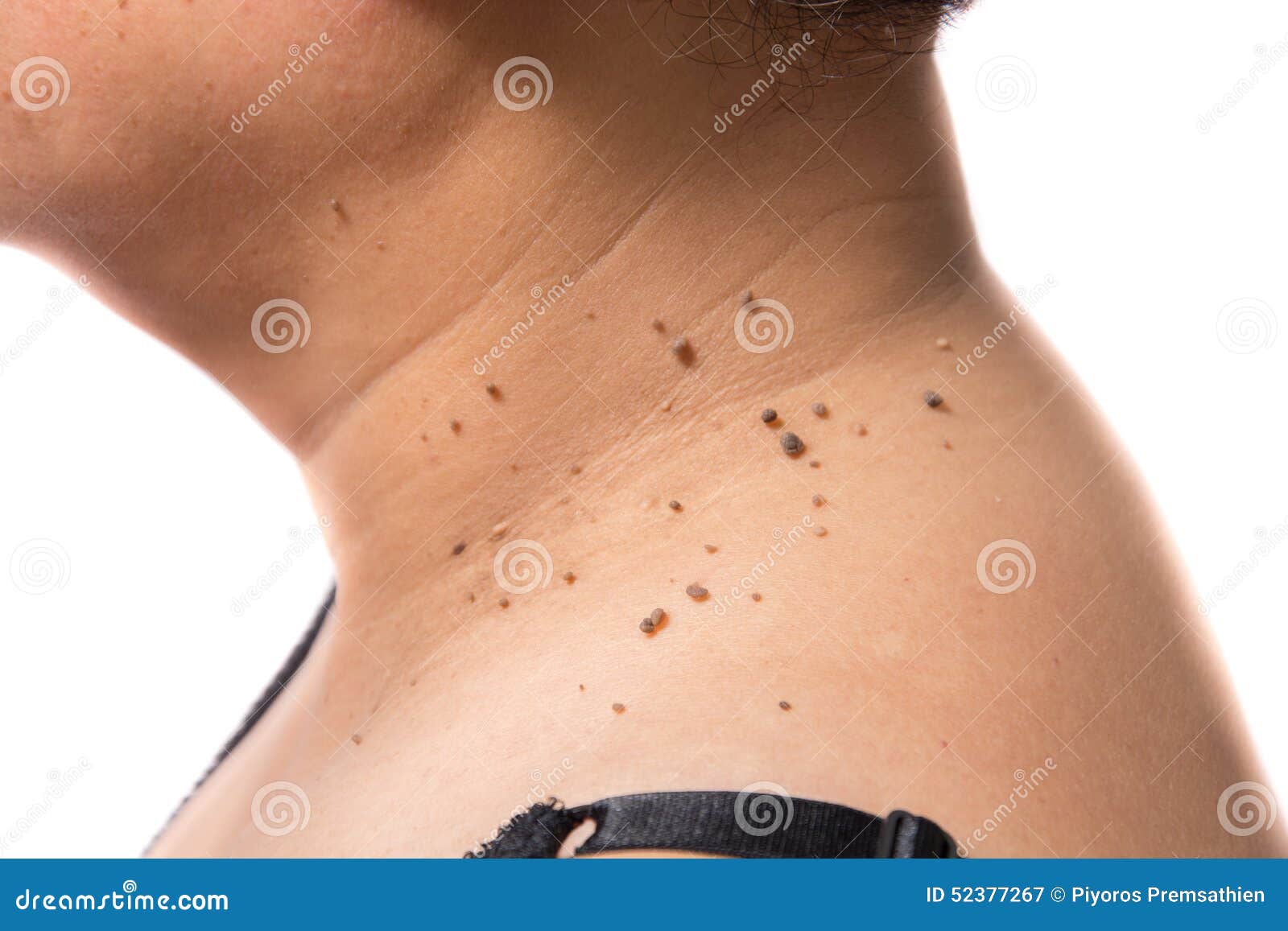 Skin of a woman with moles stock image. Image of mark - 52377267