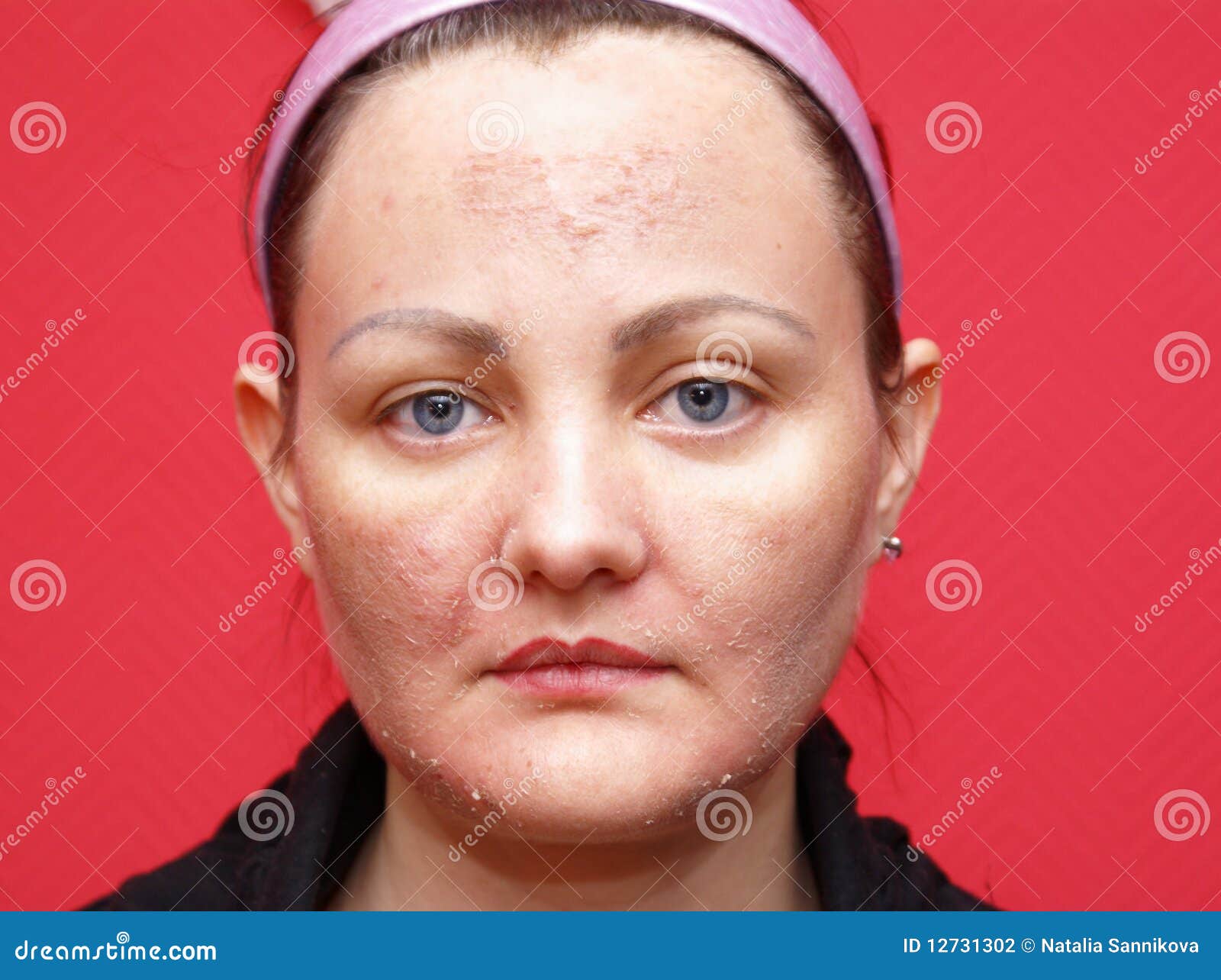 Skin woman peeling. stock photo. Image of cosmetology - 12731302