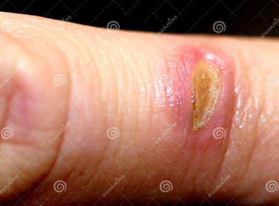 Skin Wound. Burn on the Skin of the Finger. Stock Image - Image of ...