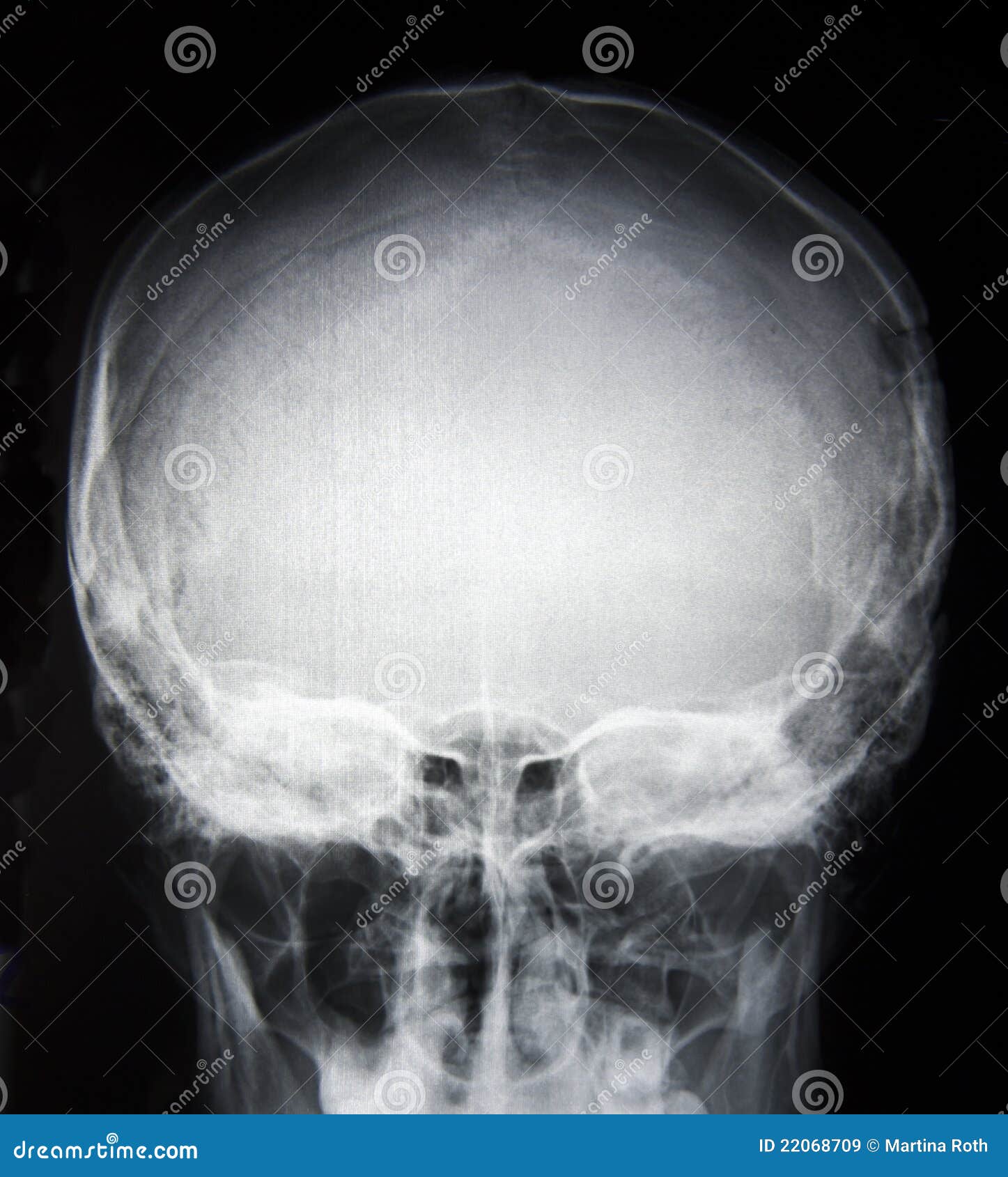 Skull base stock image. Image of orthopedic, silver, body - 22068709