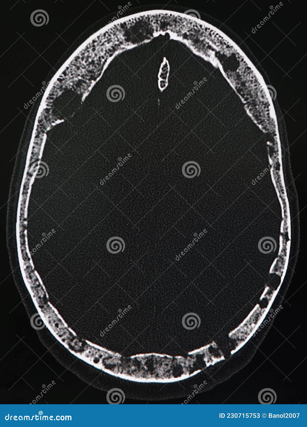 Multiple Myeloma of Skull. Ct-scan Stock Image - Image of hematology ... Multiple Myeloma of Skull. Ct-scan Stock Image - Image of hematology ...