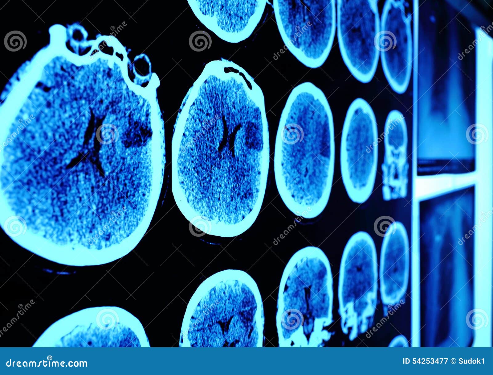 Skull CT Scan Picture on the Wall Stock Illustration - Illustration of ...