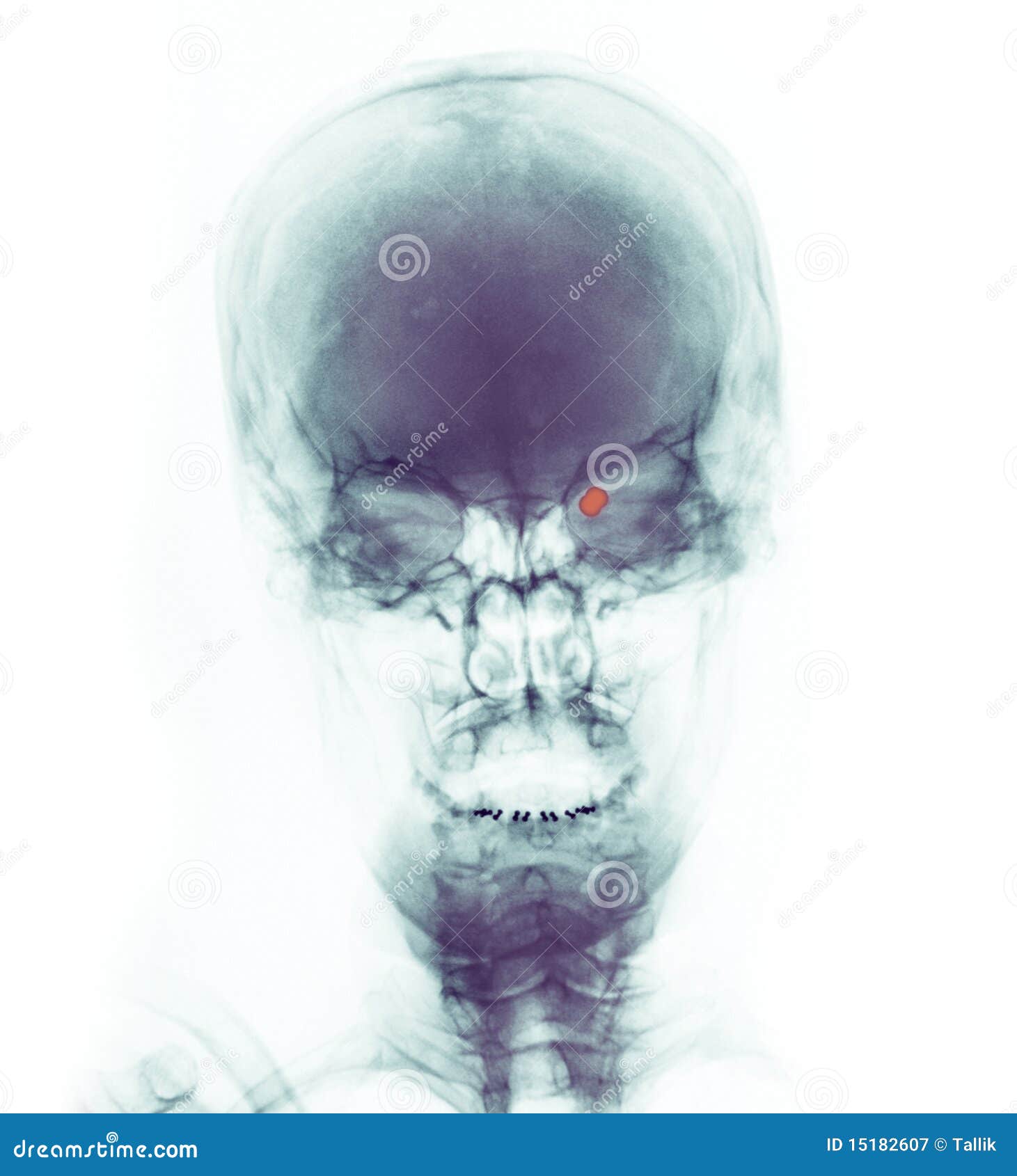 Skull X-ray, 73 Year Old Woman Stock Image - Image of medicine, head ...