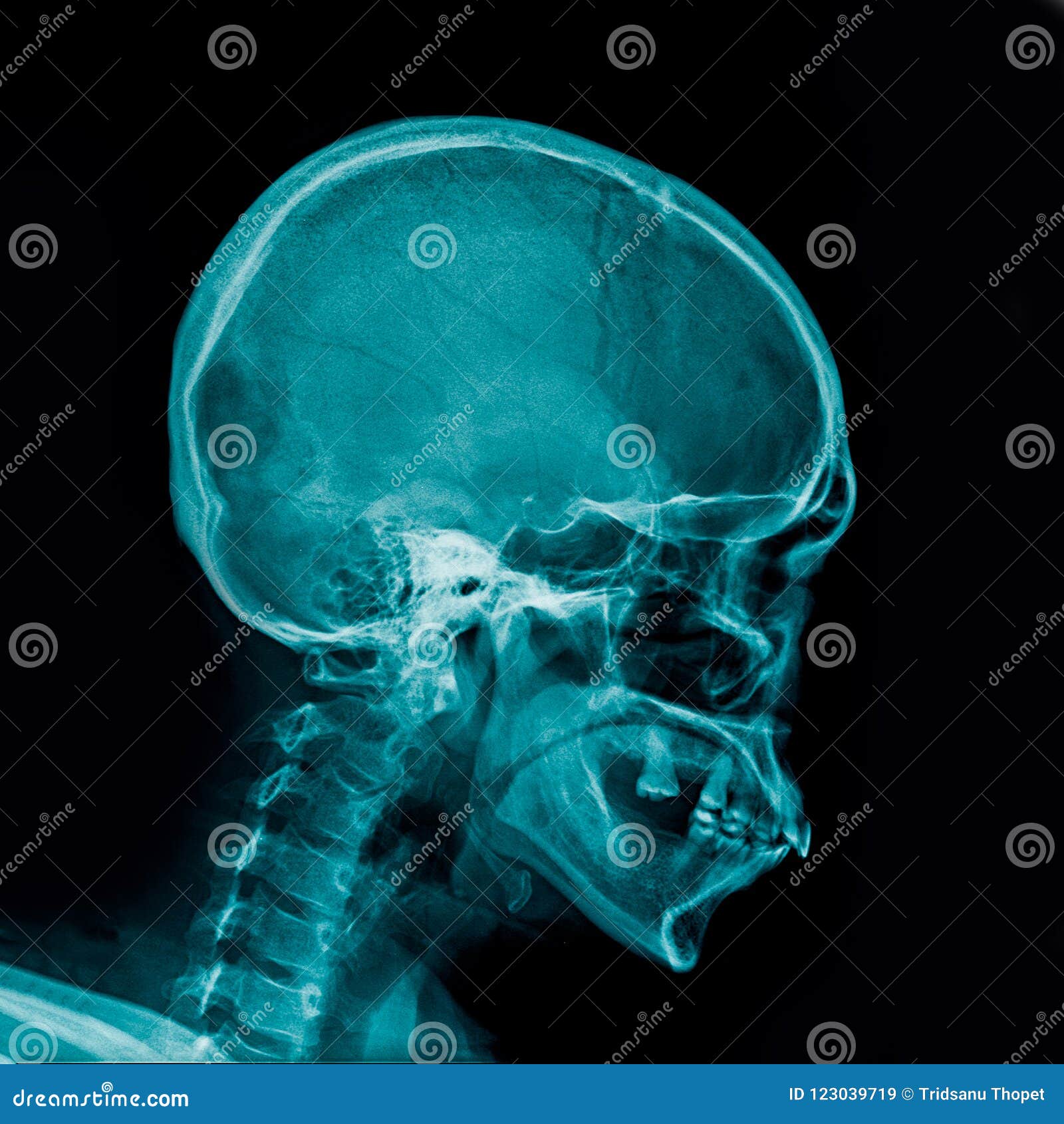 Skull X-ray AP and Lateral View Stock Illustration - Illustration of ...