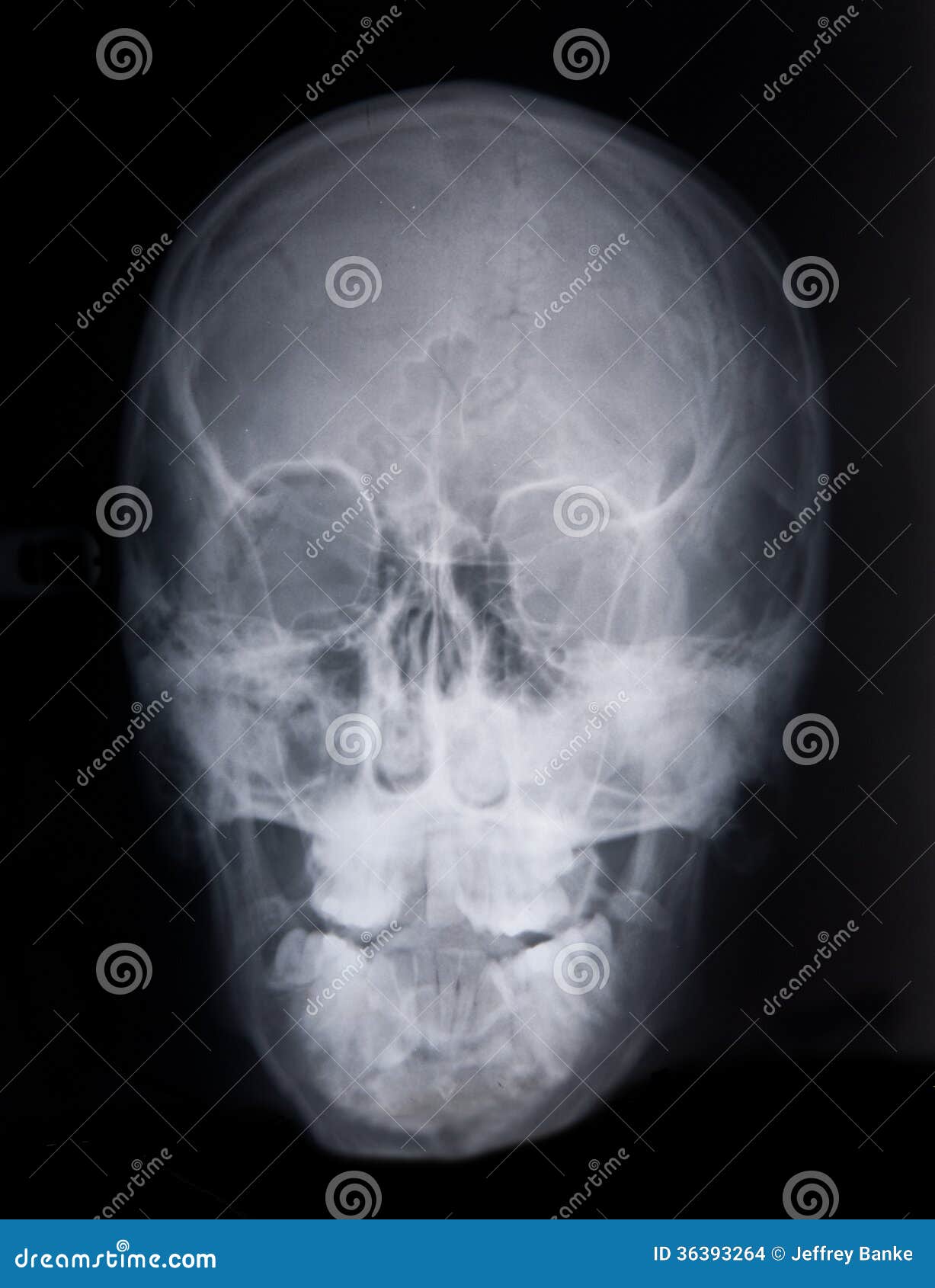 Skull stock photo. Image of fracture, adult, scan, anatomy - 36393264