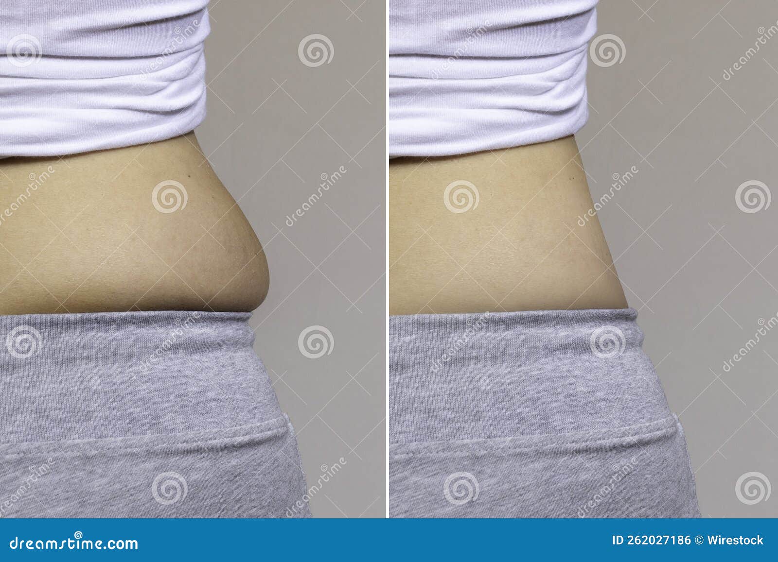 Slim and Fat Side Belly Comparison of a Woman Stock Photo - Image of ...