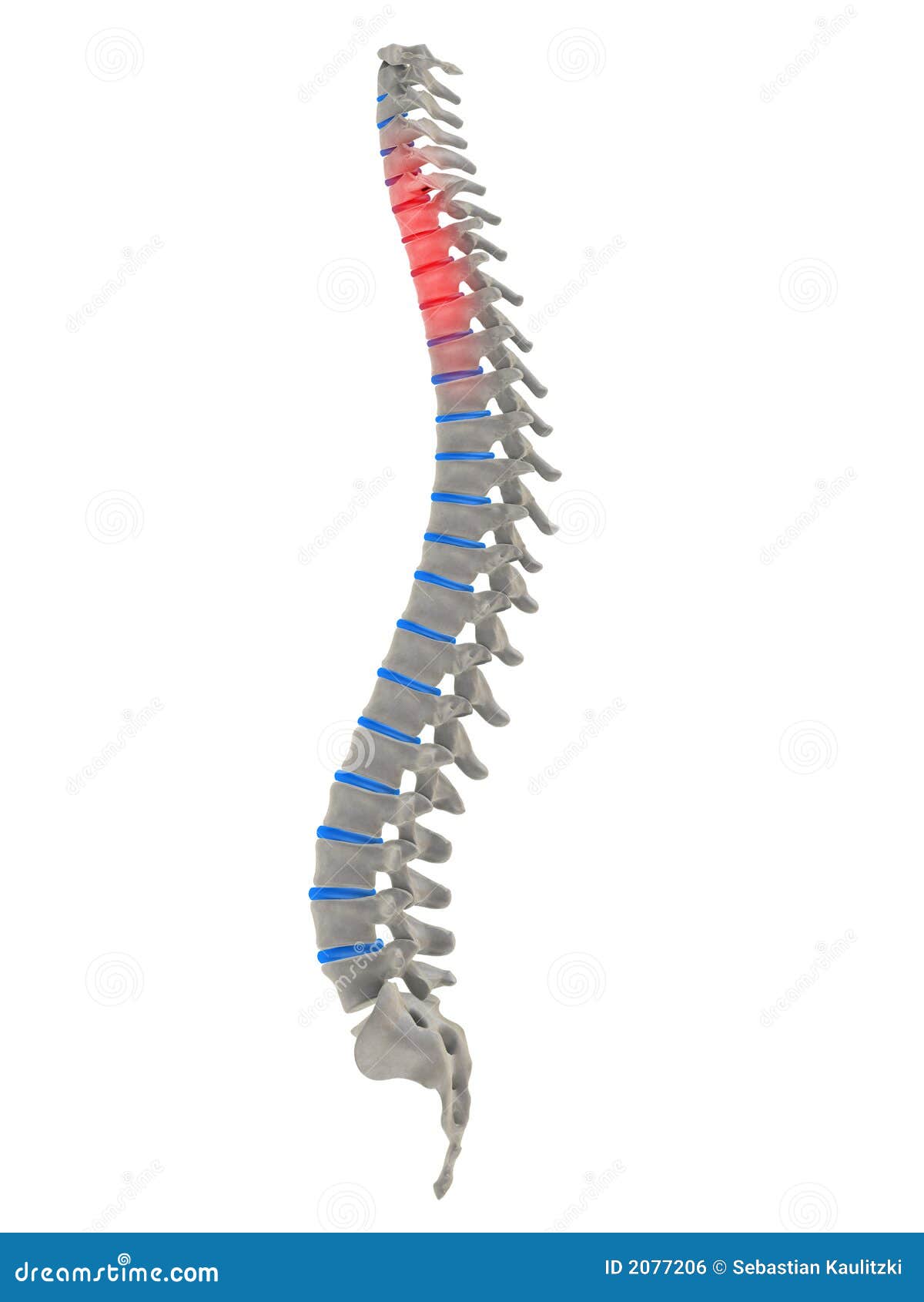 Slipped Disc Prolapse Back Pain Spine Cartoon Vector | CartoonDealer ...