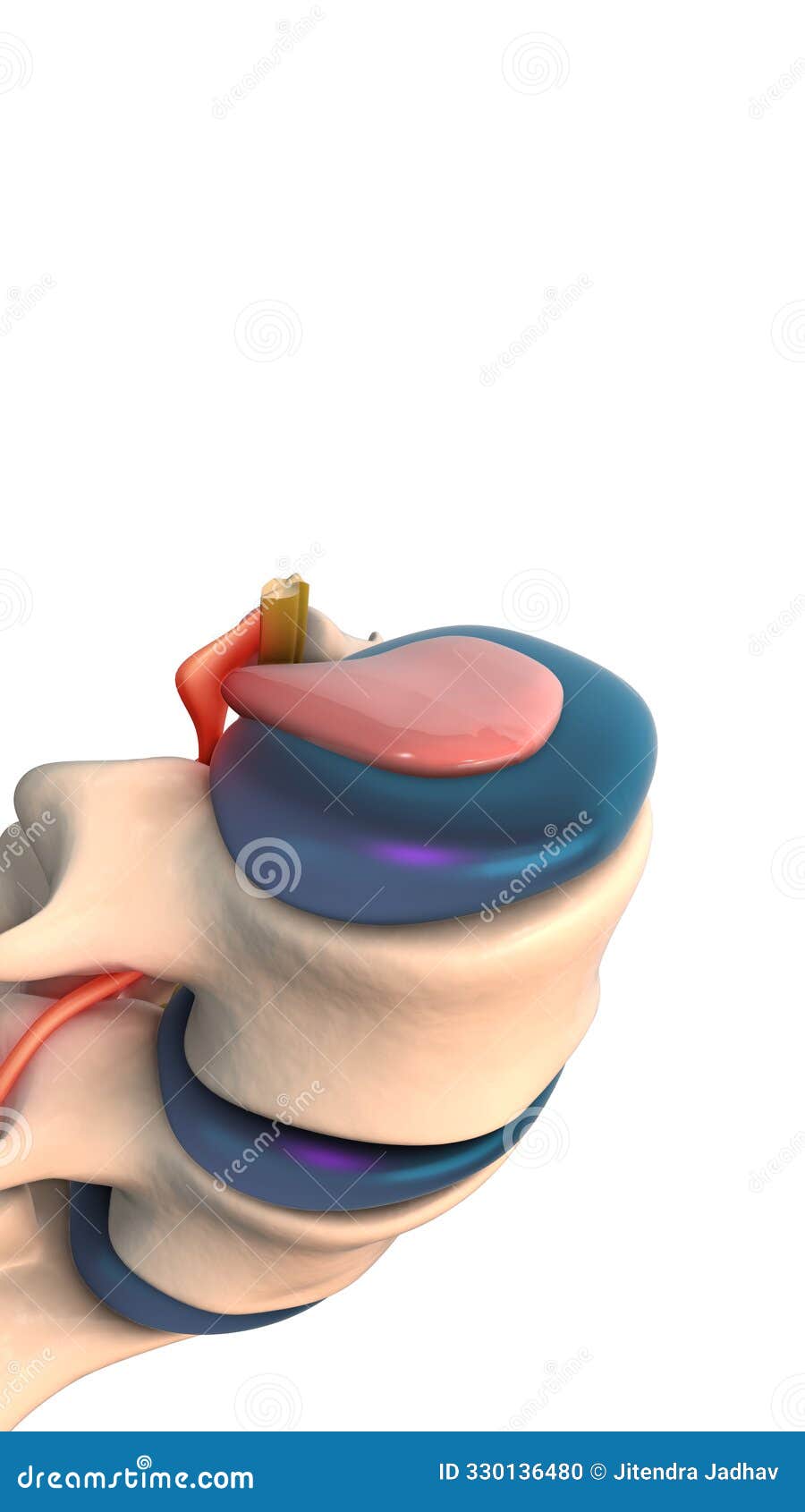 Slipped Disk or a Ruptured Disk Stock Illustration - Illustration of ...