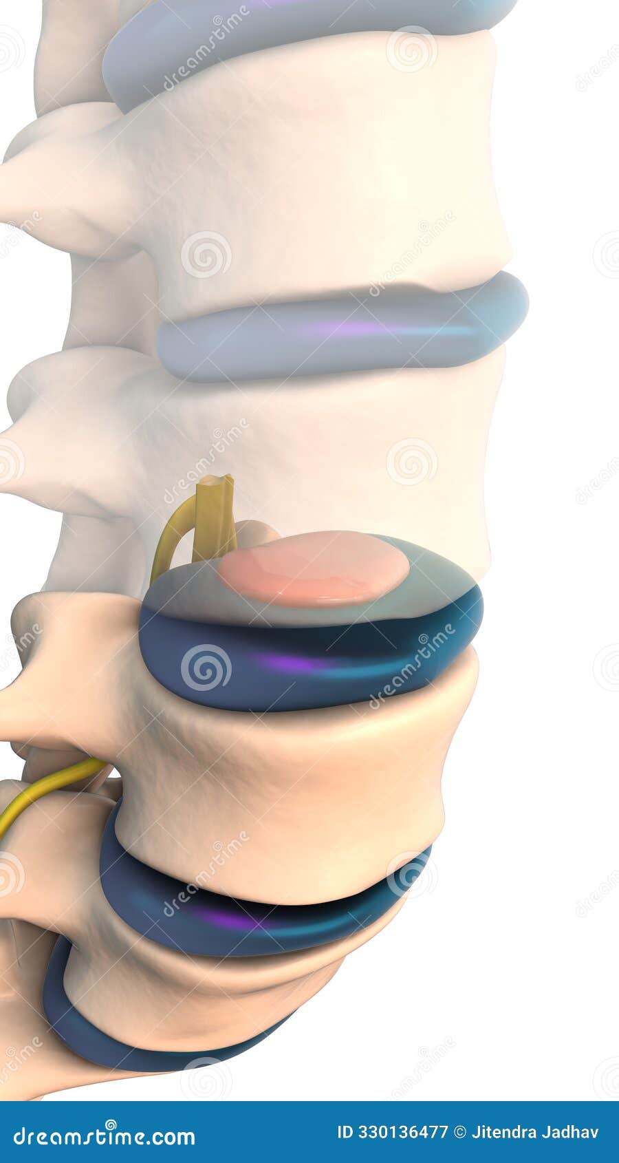 Slipped Disk or a Ruptured Disk Stock Illustration - Illustration of ...