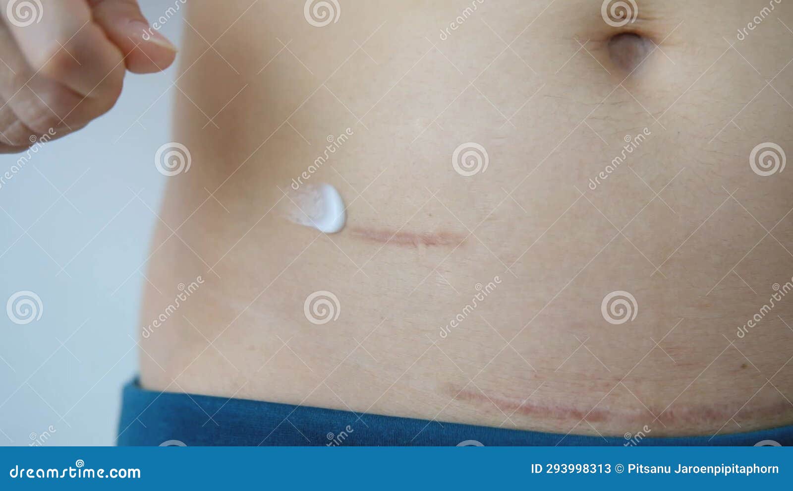 Slow Motion Using Cream To Care for Scars after Appendix Surgery. Stock ...