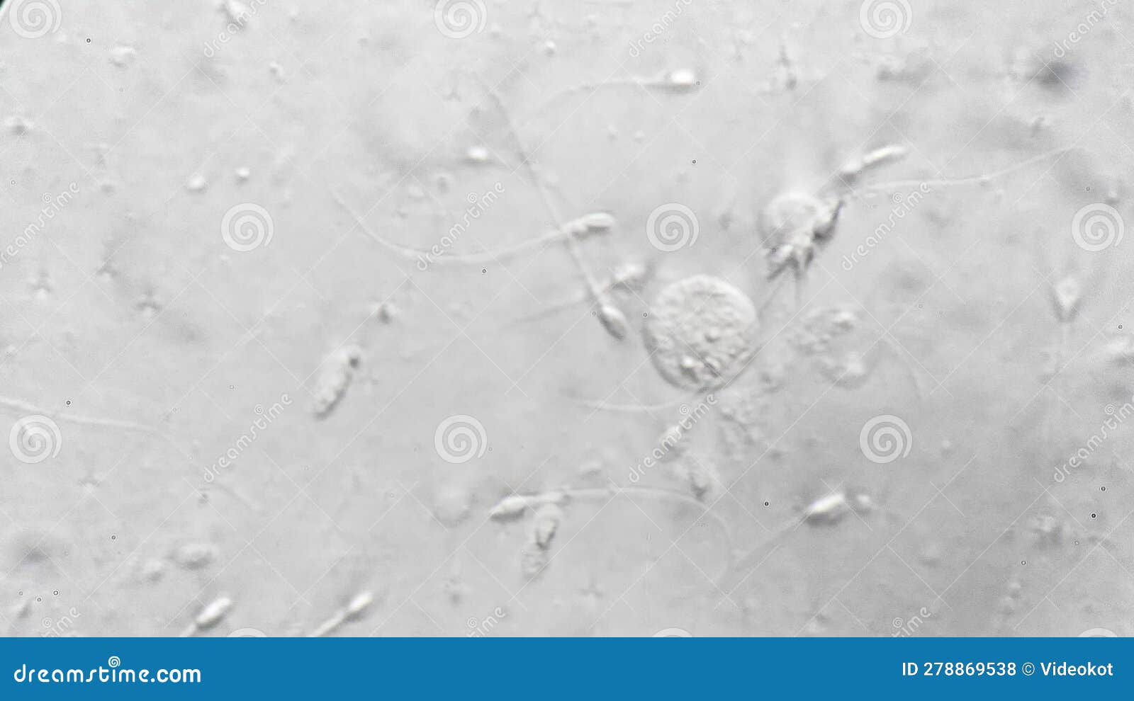 Sluggish Spermatozoa of Sick Man in Medical Spermogram Test Under ...