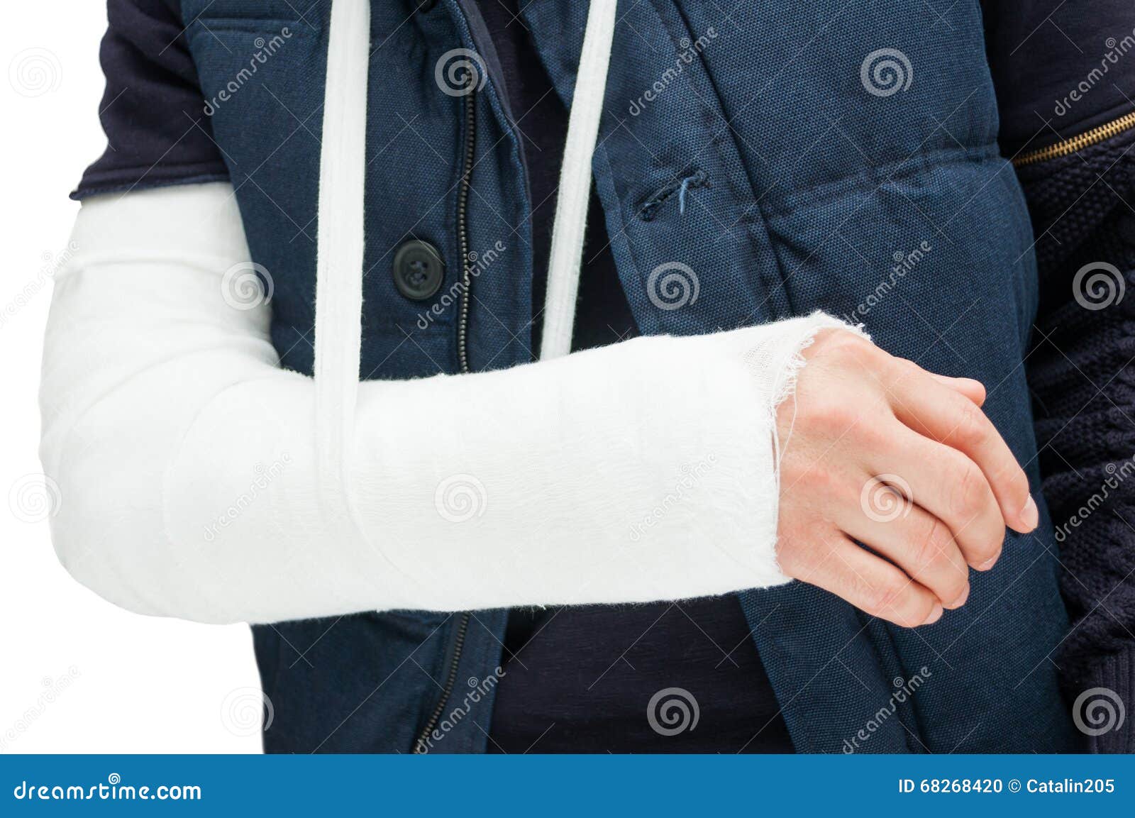 Sluit Omhoog Hand Met Verband En Gips Stock Foto - Image of ...