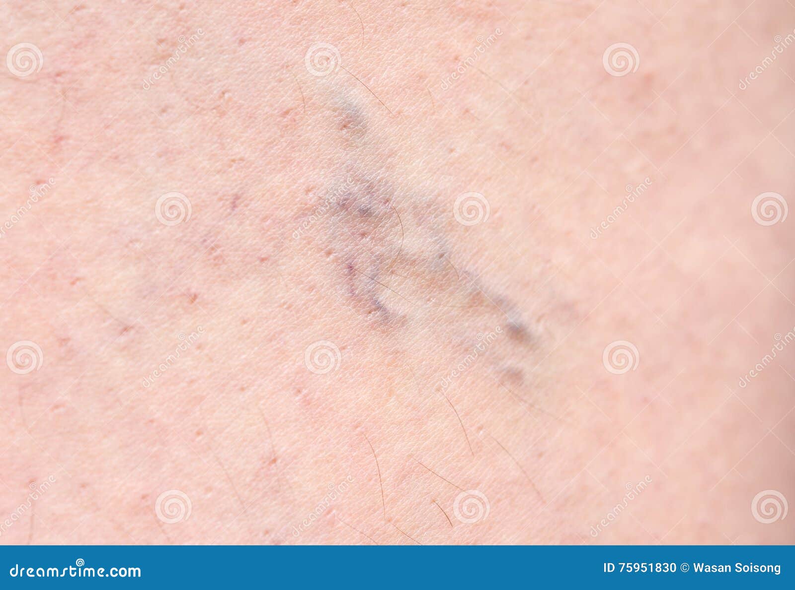 Sluit Omhoog Spataders Op De Huid Stock Foto - Image of aders, medisch ...