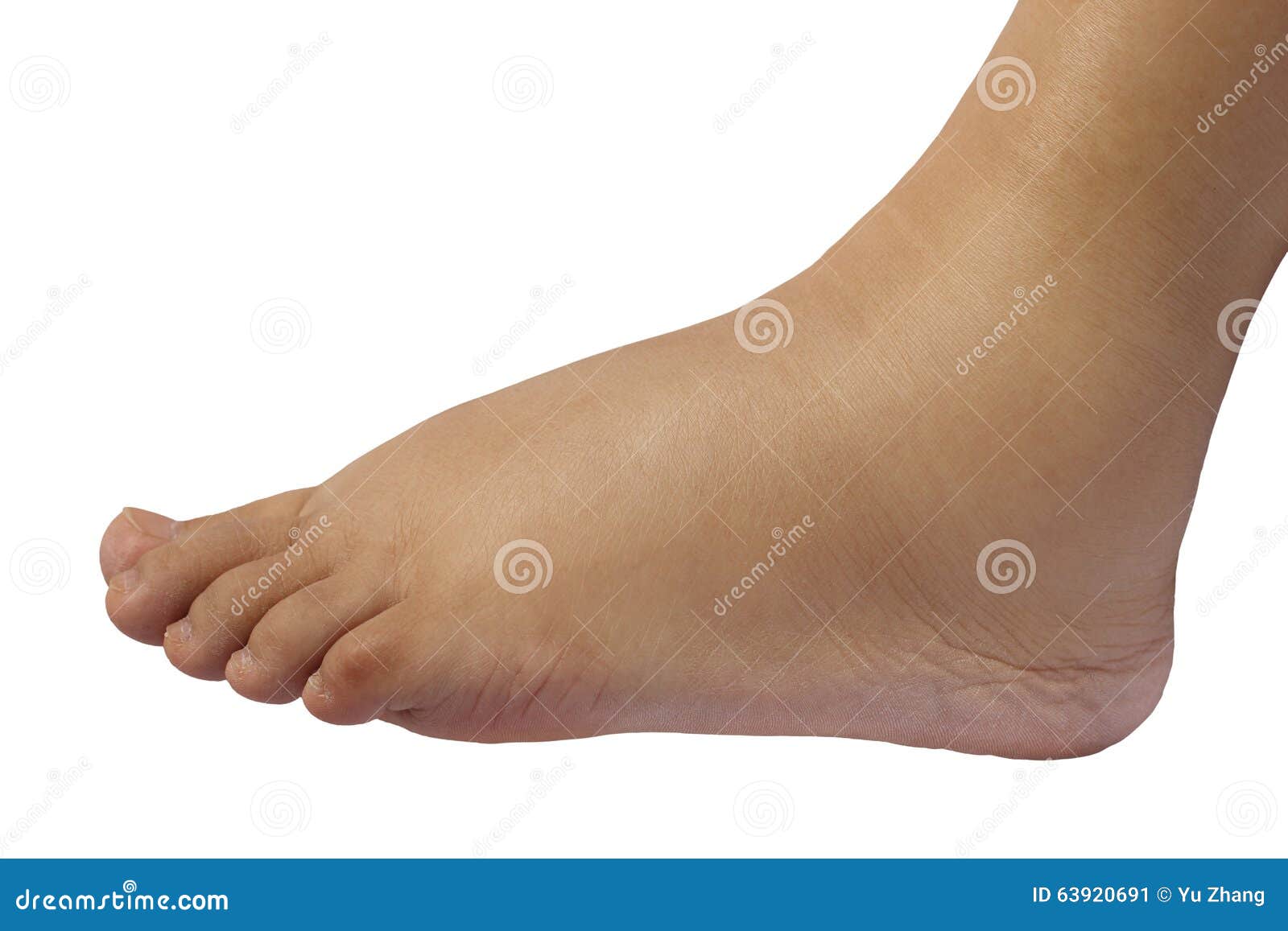 Sluit Omhoog Van De Gezwollen Voet Van Een 35 Weken Zwangere Vrouw Stock Afbeelding Image Of