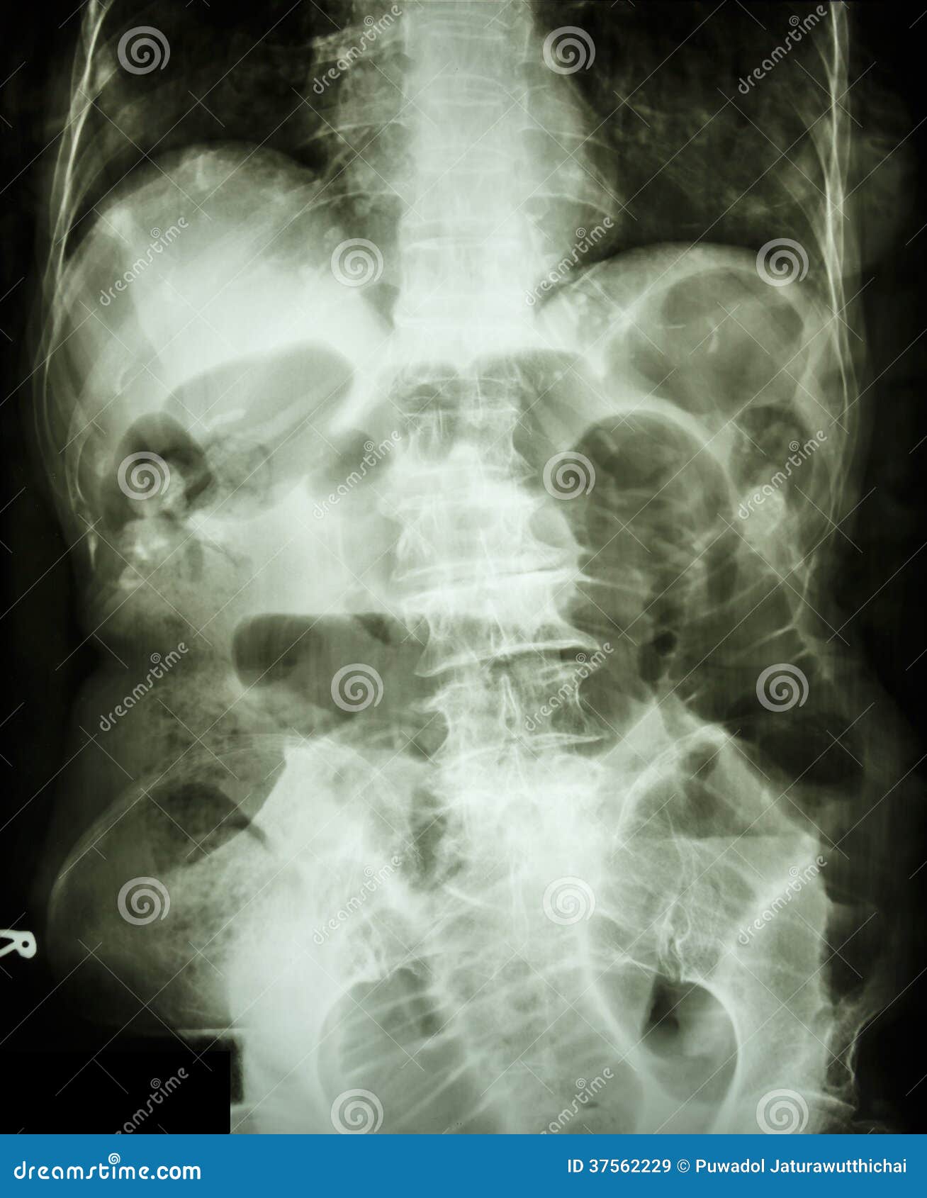 Small Bowel Obstruction ( Film X-ray Abdomen ( Supine Position ) : Show ...