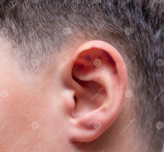 Small bruises on the ear stock photo. Image of spots - 163363166