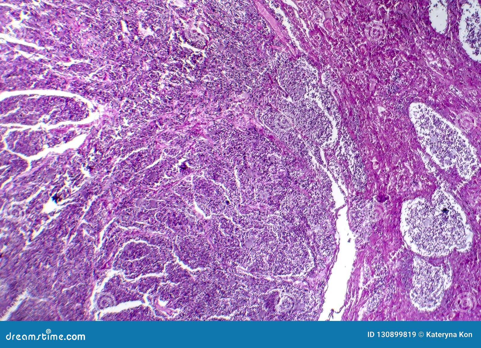 Small cell lung cancer stock image. Image of micrograph - 130899819