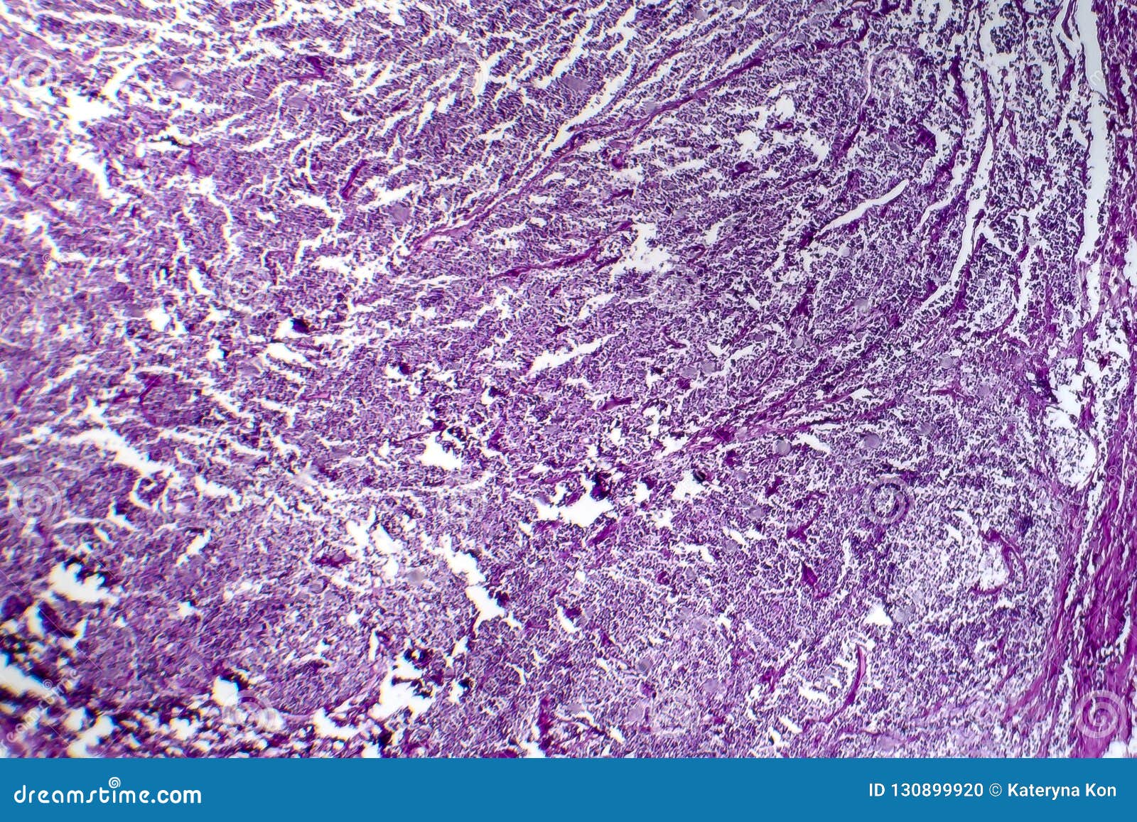 Small cell lung cancer stock photo. Image of photomicrograph - 130899920