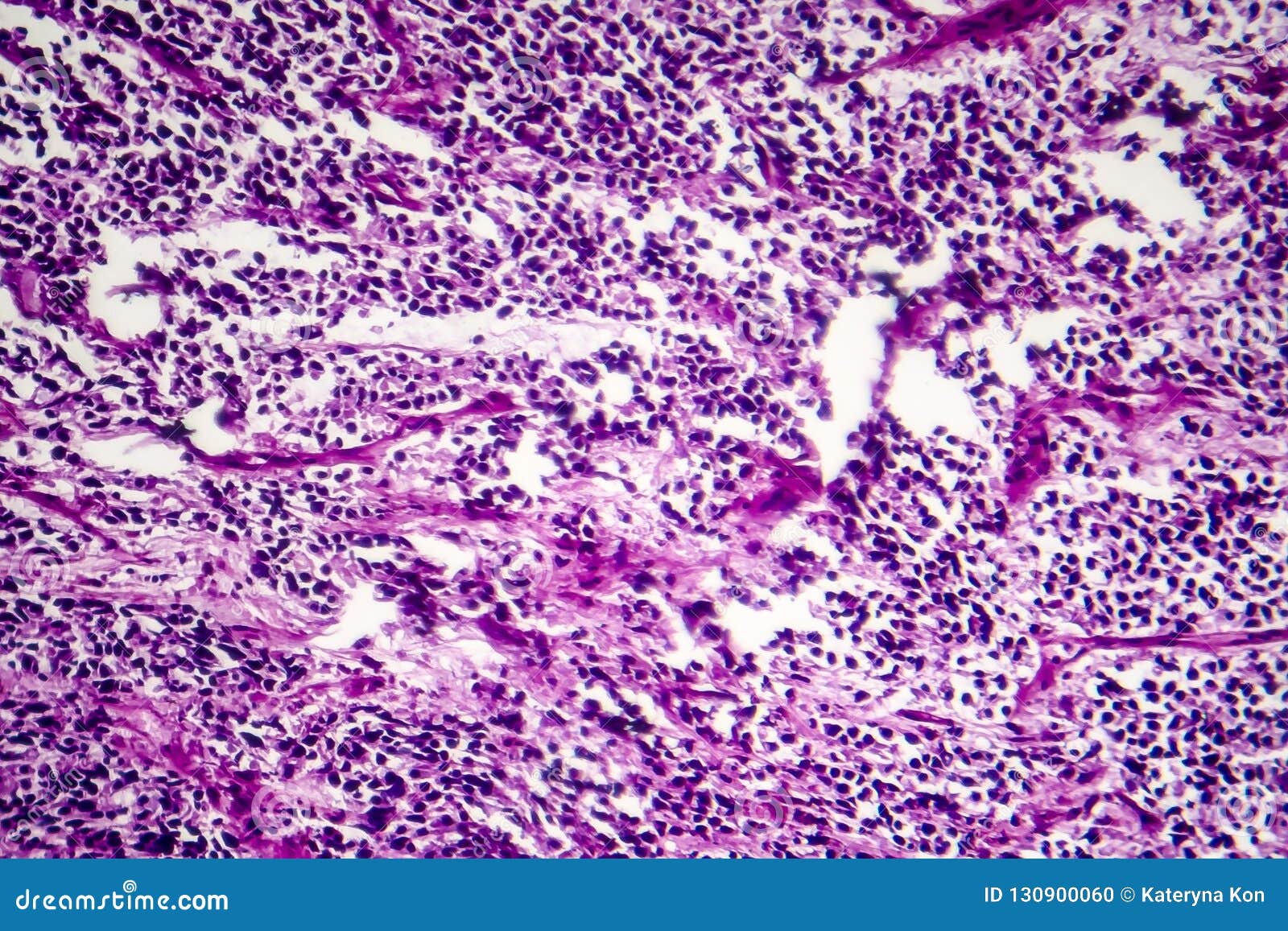 Small cell lung cancer stock photo. Image of lung, photomicrograph ...