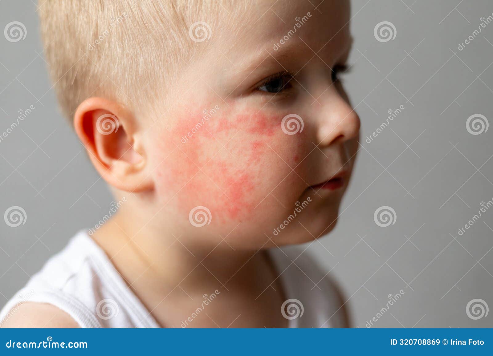 Small Child with Red Rash on Cheek Stock Image - Image of outbreak ...