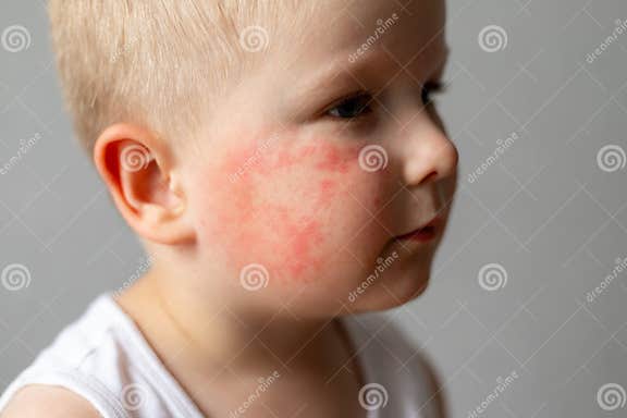 Small Child with Red Rash on Cheek Stock Image - Image of outbreak ...