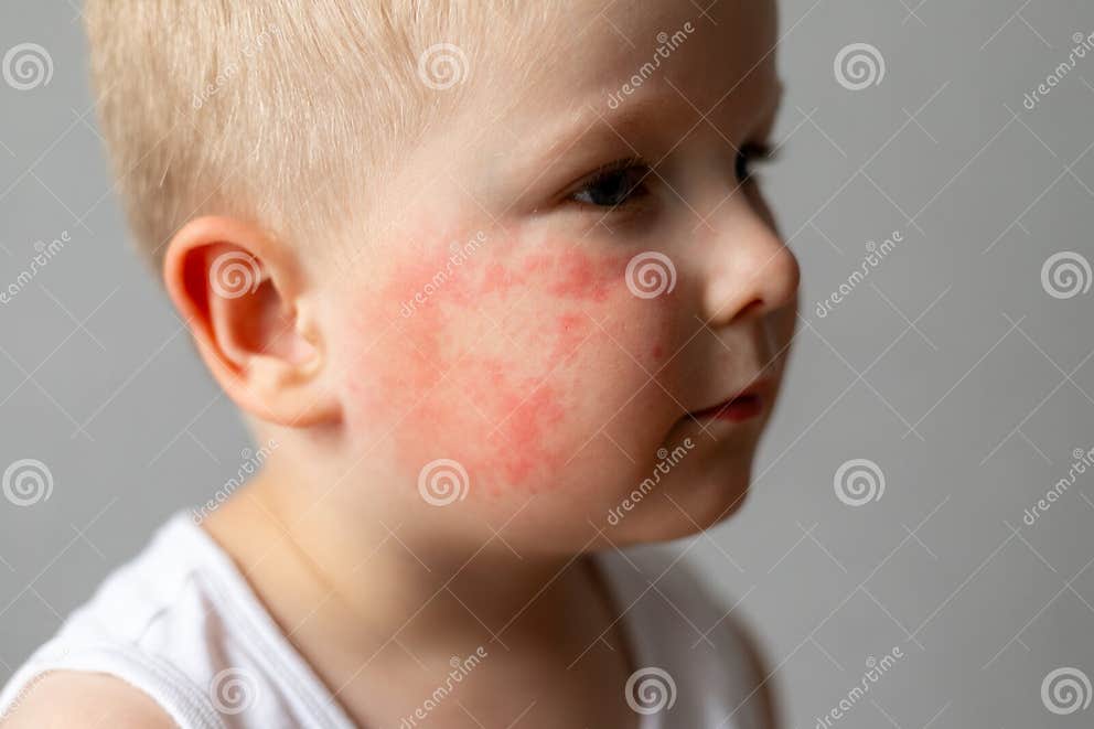 Small Child with Red Rash on Cheek Stock Image - Image of outbreak ...
