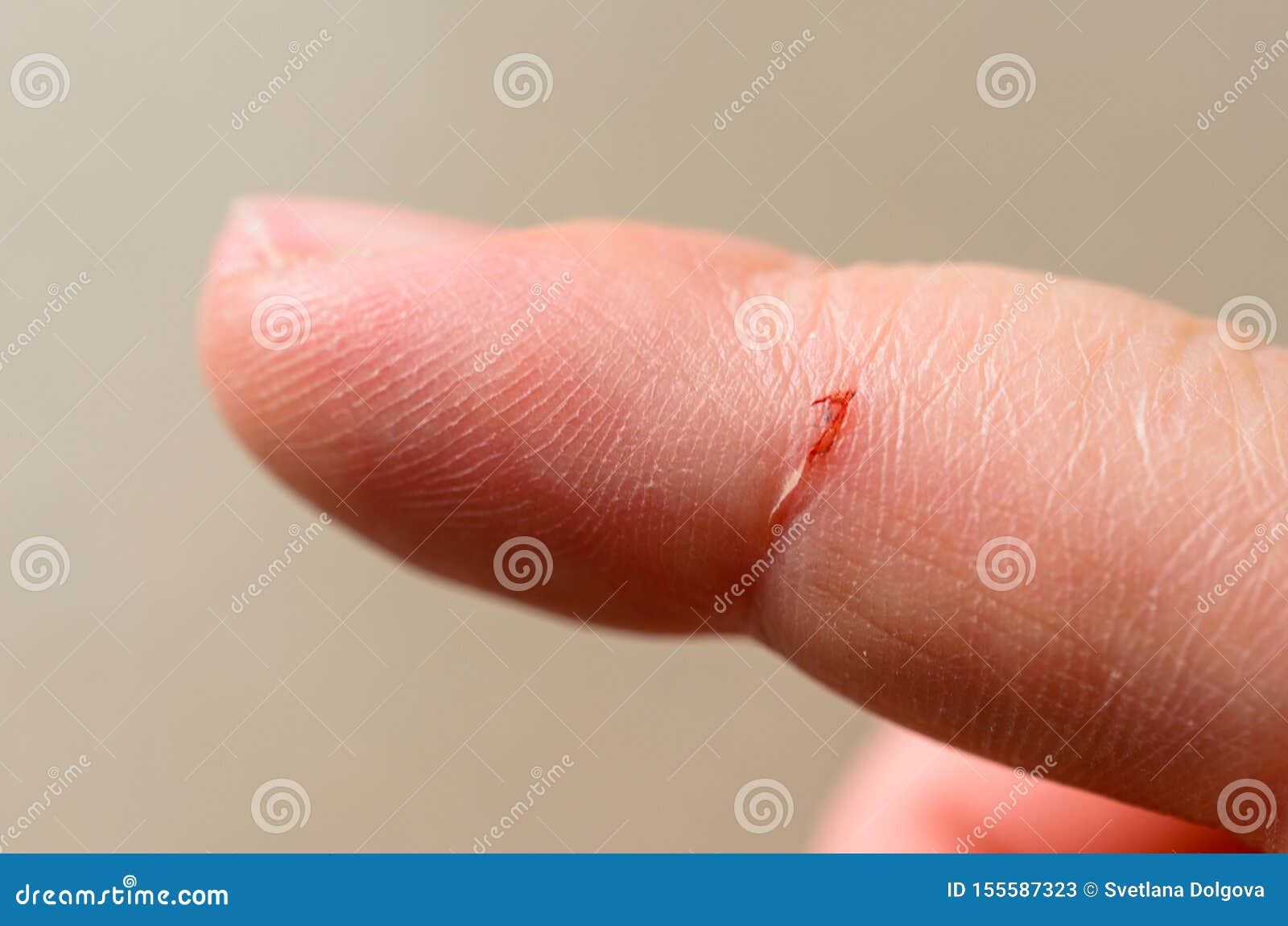 Open Cut Wound on the Index Finger Stock Image - Image of medicine ...