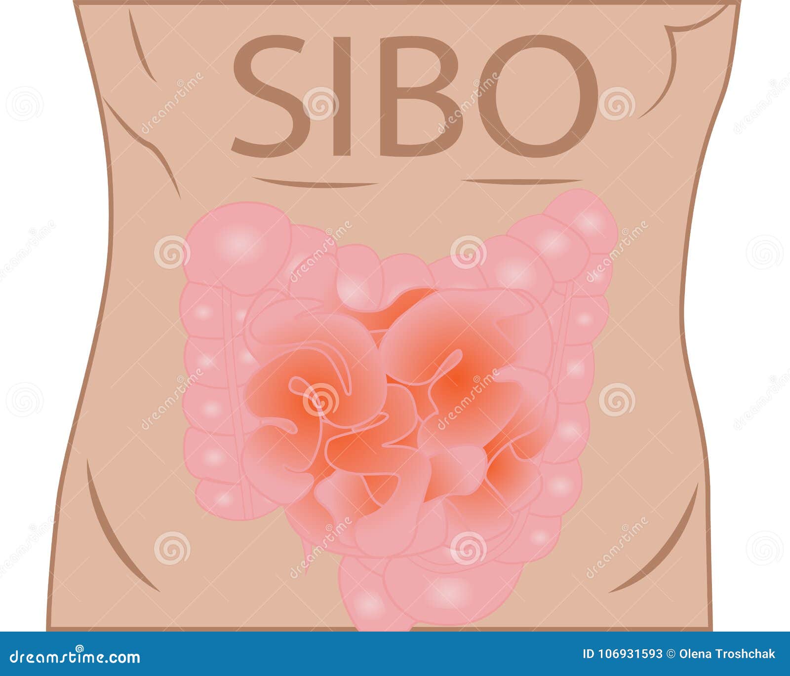 Small Intestinal Bacterial Overgrowth - SIBO Stock Vector ... Small Intestinal Bacterial Overgrowth - SIBO Stock Vector ...