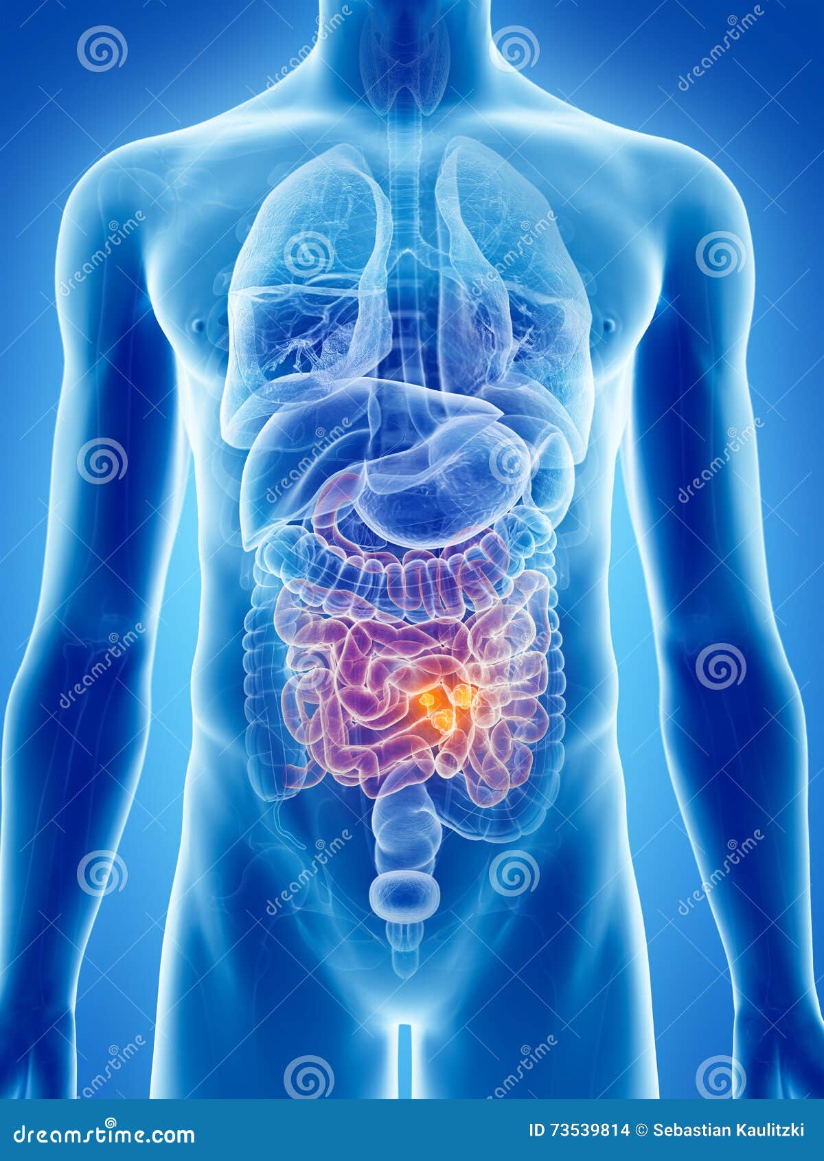 Small intestine cancer stock illustration. Illustration of anatomical ...