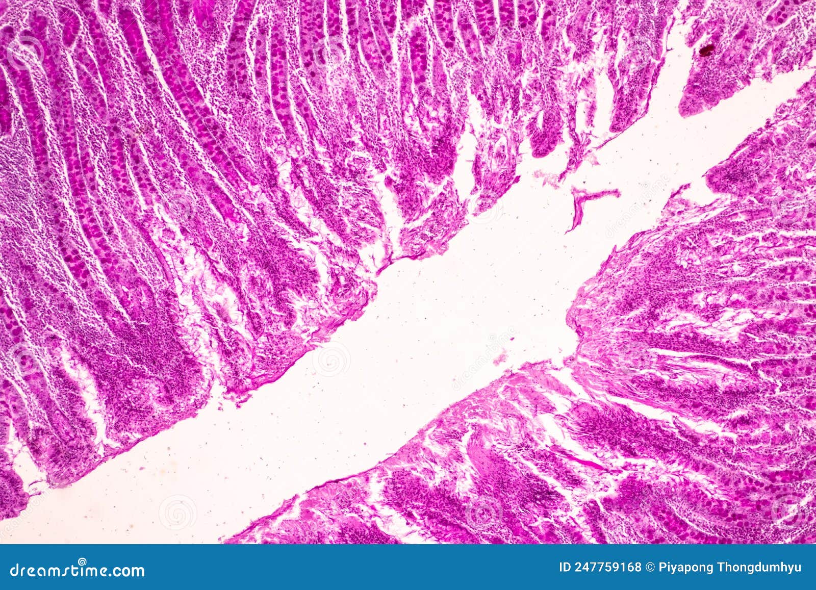 Small Intestine Duodenum and Vermiform Appendix Human Under the ...