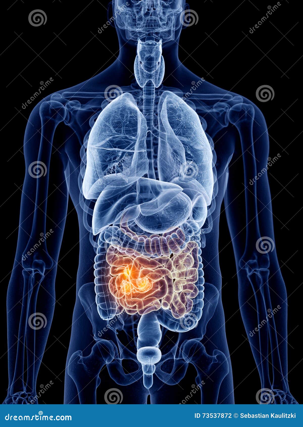 The Small Intestine with Tumor Stock Illustration - Illustration of ...