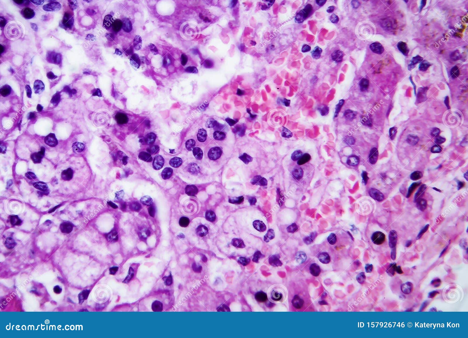 Small Nodular Cirrhosis, Light Micrograph Stock Photo - Image of ...