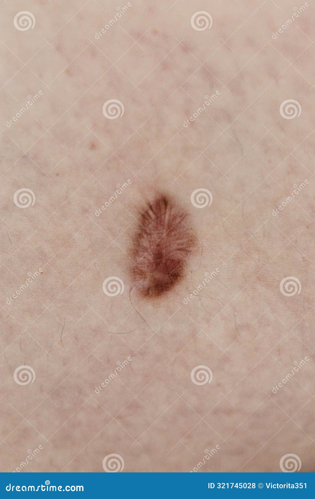 Small scar on the skin. stock photo. Image of anatomy - 321745028