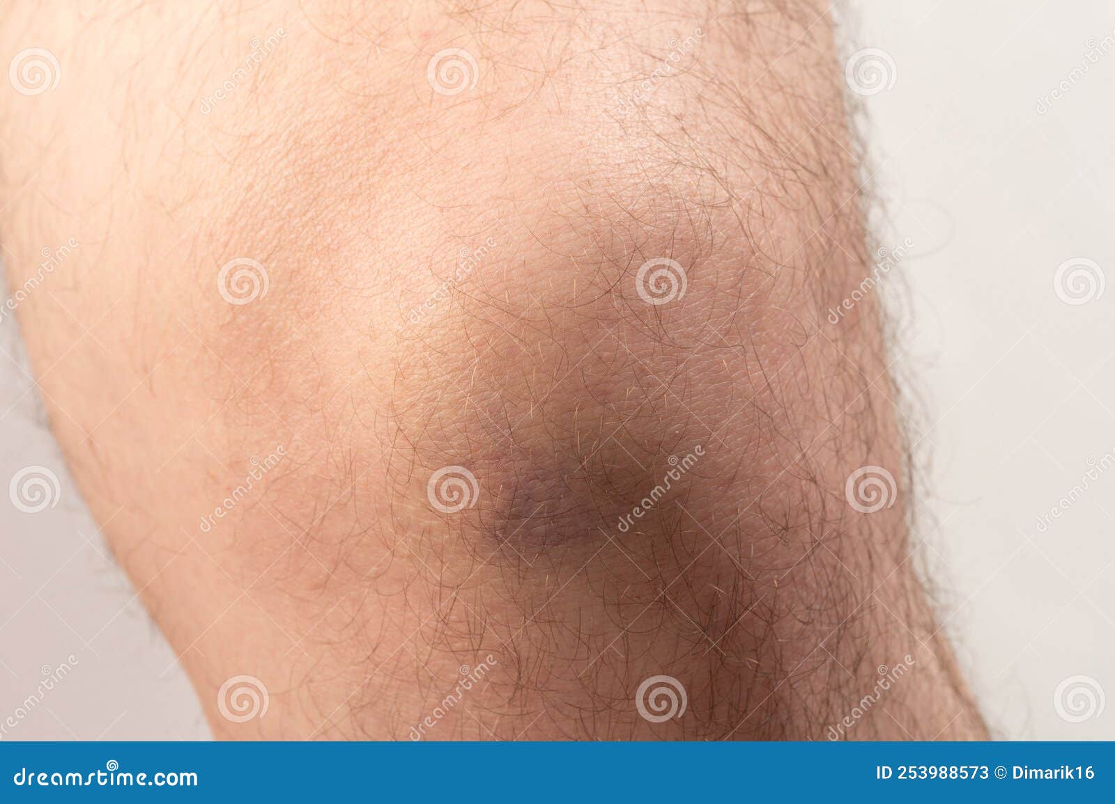 A Wound On The Human Body, Suture Old, Deep Cut, Scar Close-up Royalty ...