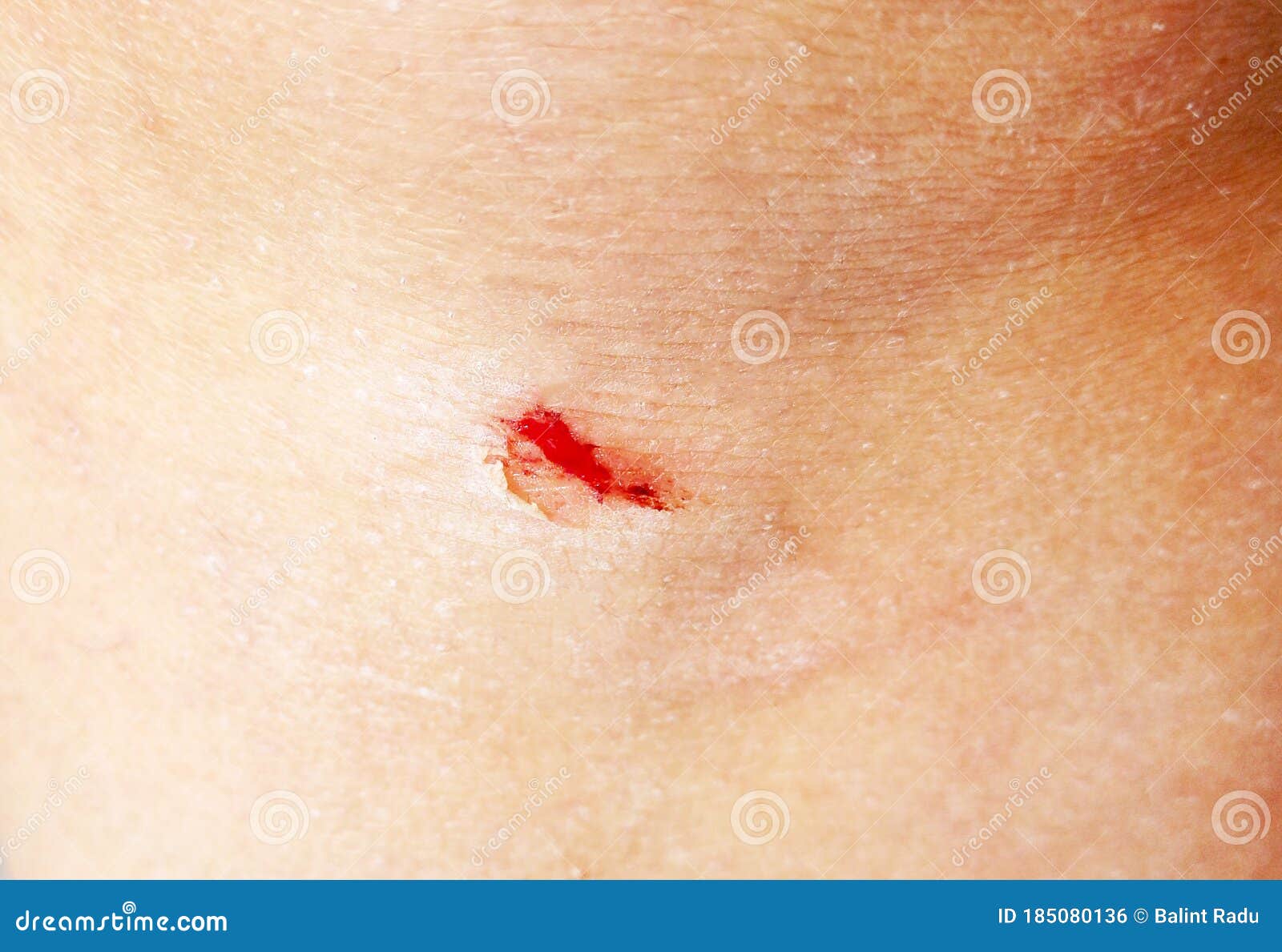 Small wound on the knee stock photo. Image of bruise - 185080136