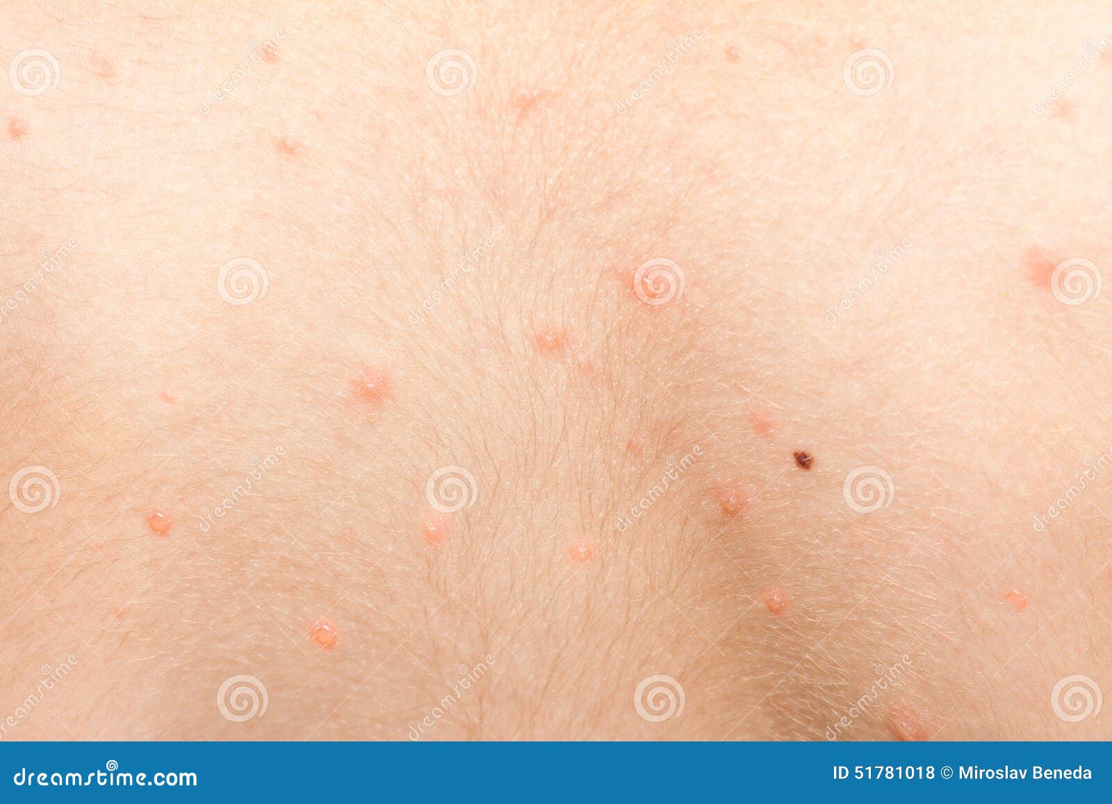 Smallpox stock photo. Image of close, ache, child, ailing - 51781018