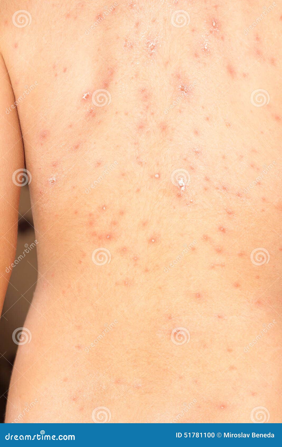 Smallpox stock photo. Image of background, macro, pock - 51781100