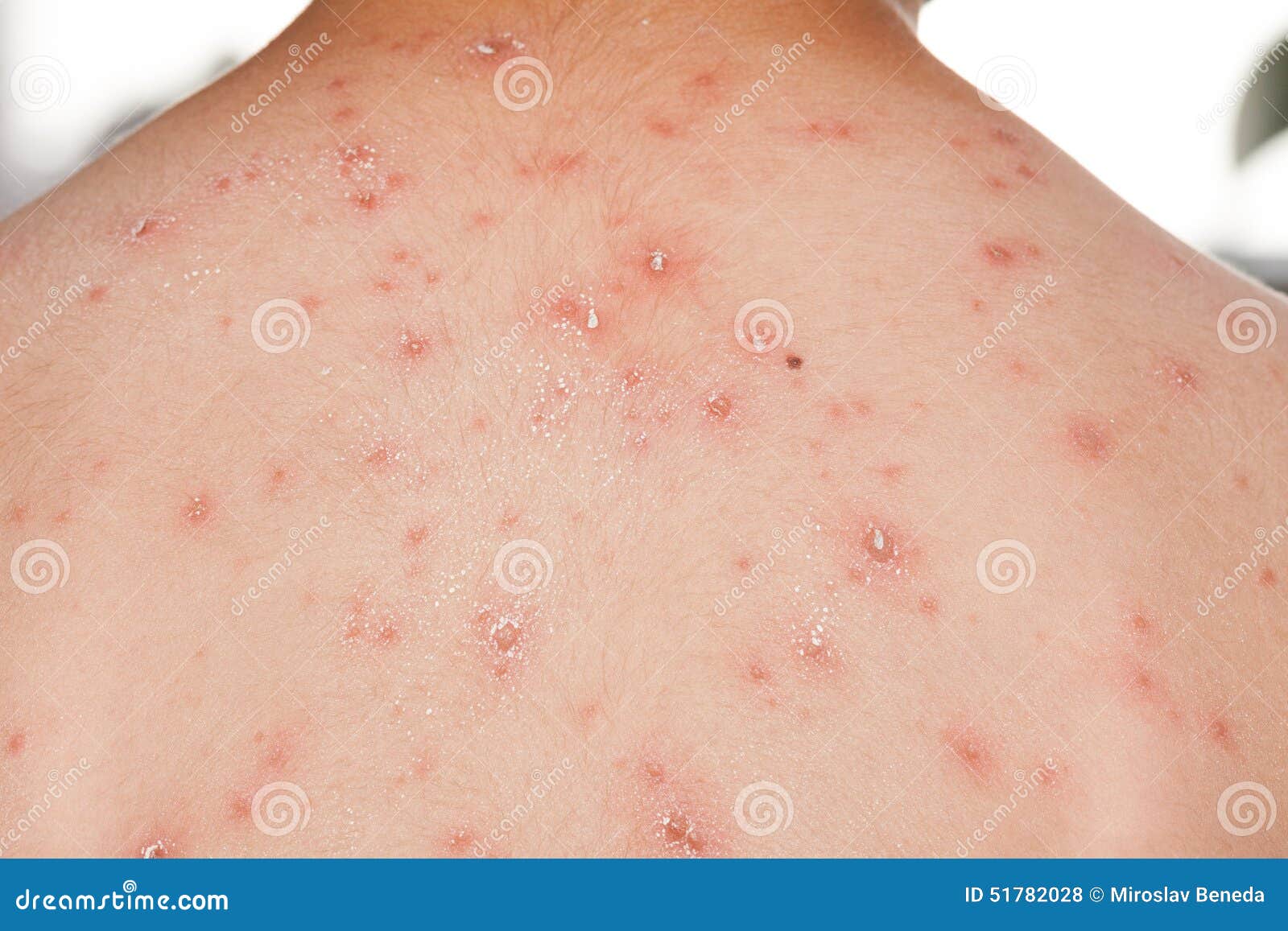 Smallpox stock photo. Image of chickenpox, pock, background - 51782028