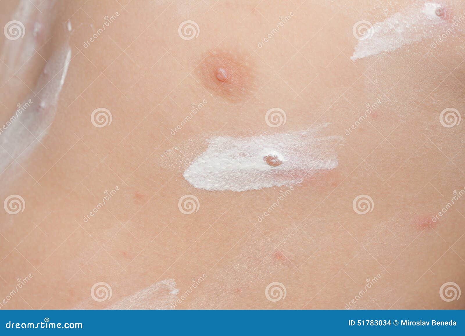 Smallpox stock photo. Image of macro, chicken, isolation - 51783034