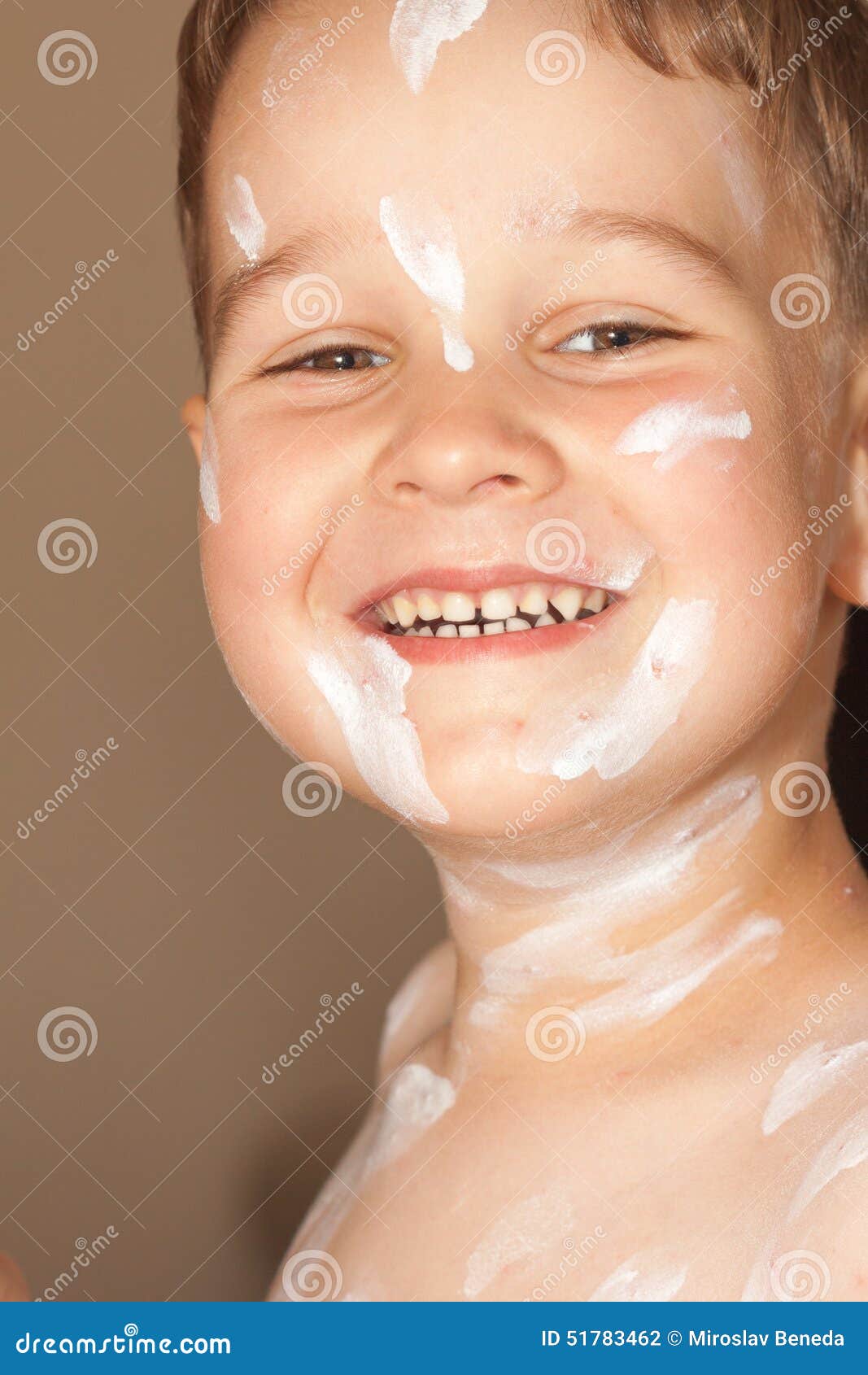Smallpox stock photo. Image of pimples, bacterial, pediatric - 51783462