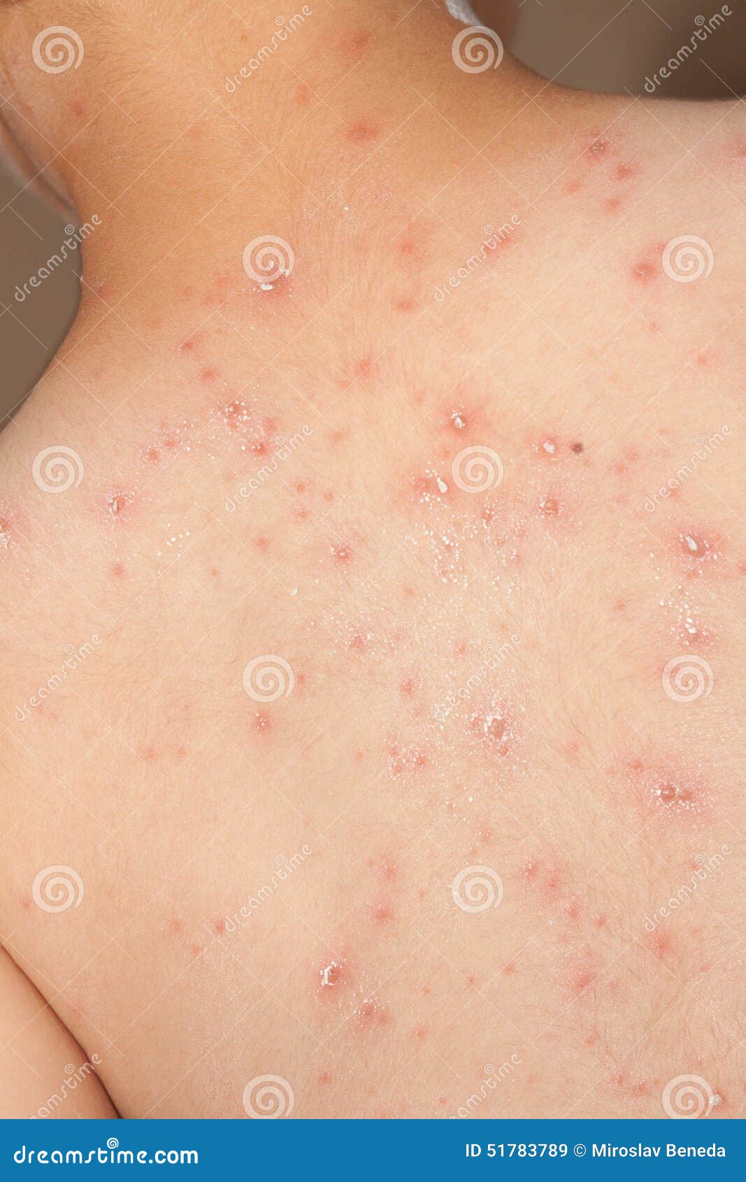 Smallpox stock image. Image of baby, body, pock, background - 51783789
