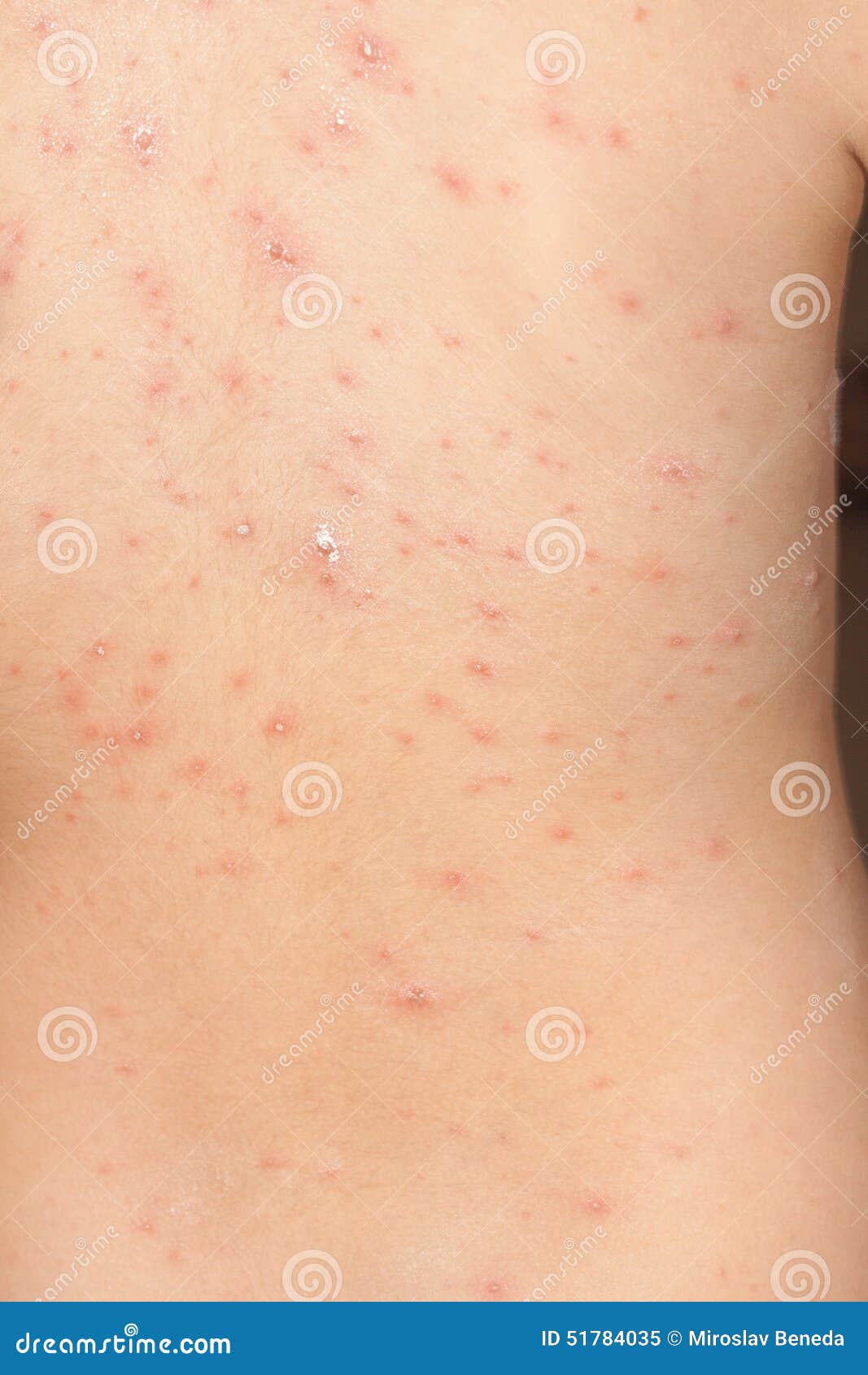 Smallpox stock image. Image of pock, afflicted, contagious - 51784035