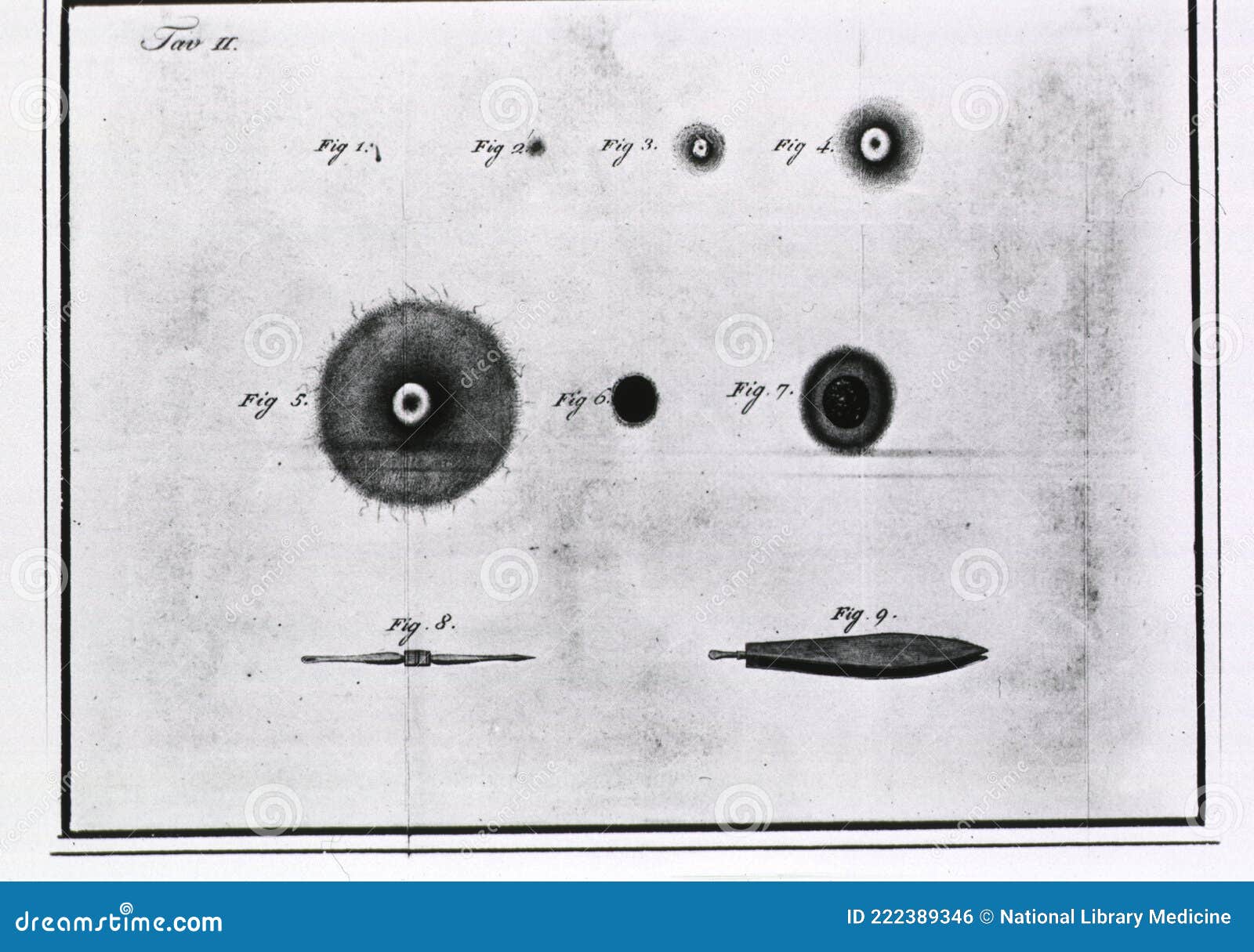 Smallpox: Instruments For Inoculation And Developing Pustule Picture ...