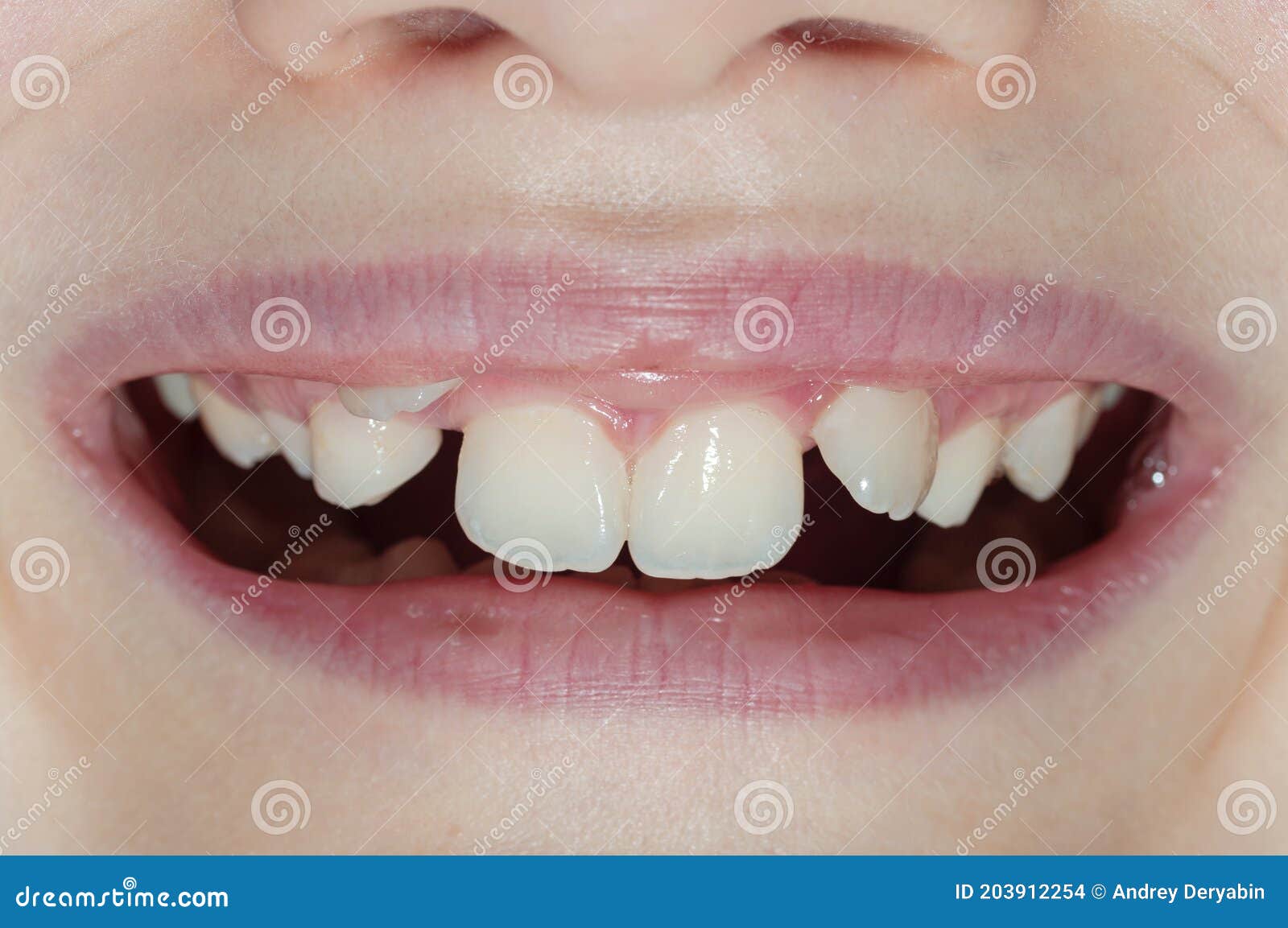 Smile of a Boy with Teeth Growth Defects Stock Photo - Image of ...