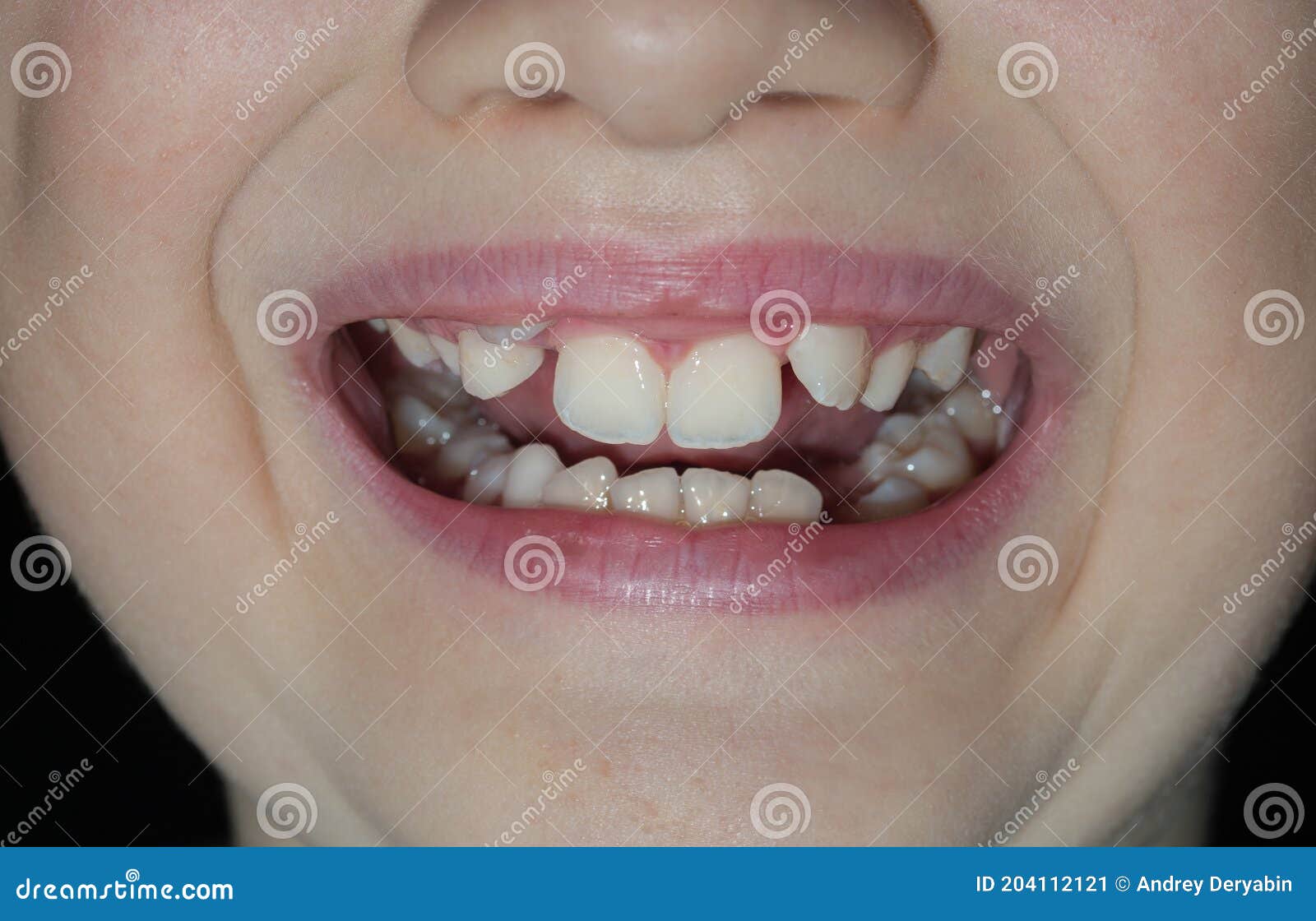 Smile of a Boy with Teeth Growth Defects Stock Image - Image of child ...