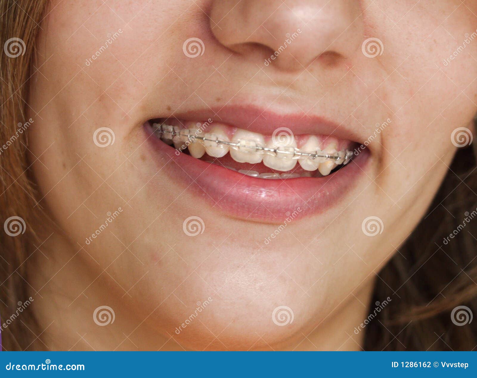 Smile with braces stock photo. Image of overbite, crooked - 1286162