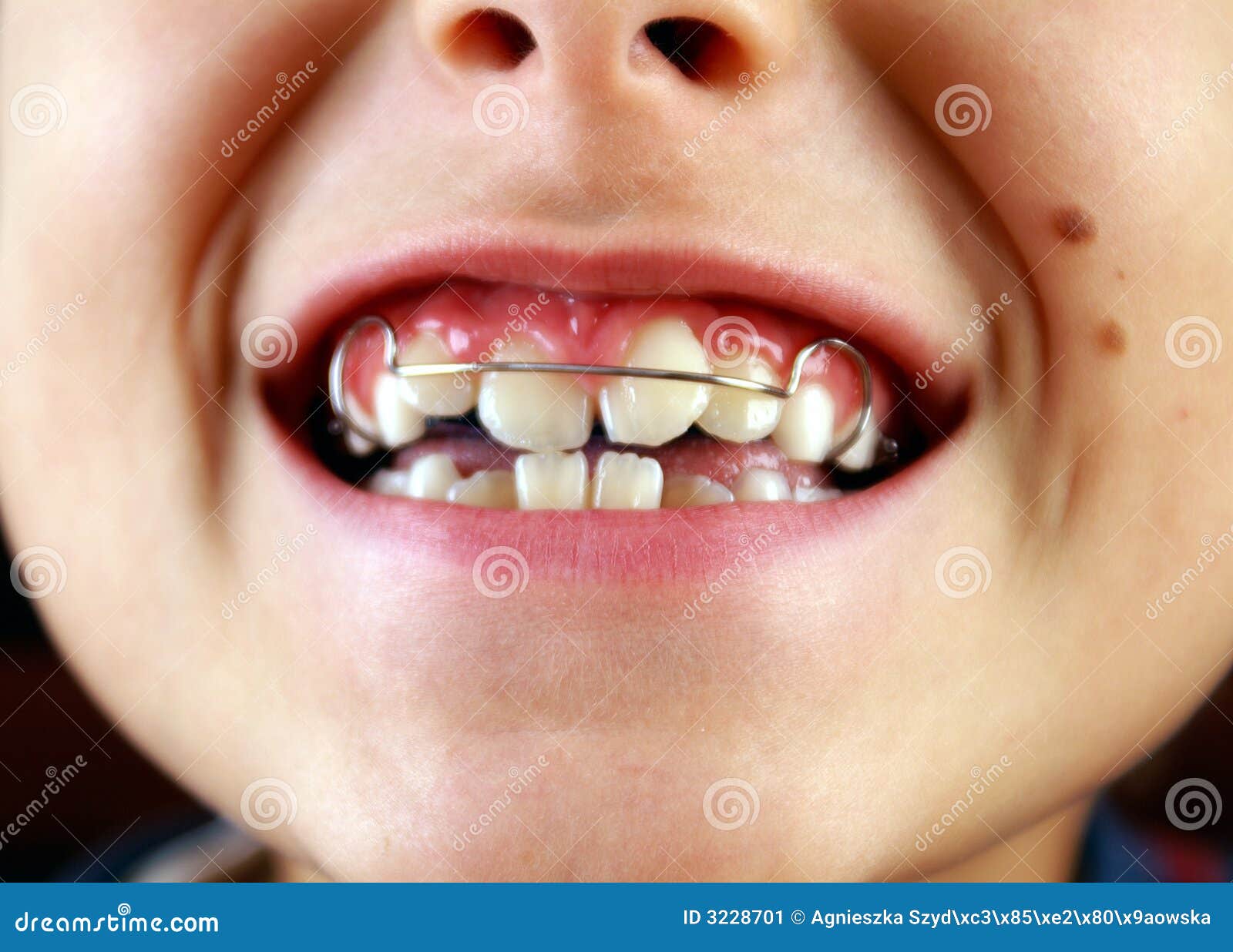 Smile with braces on teeth stock image. Image of fresh - 3228701