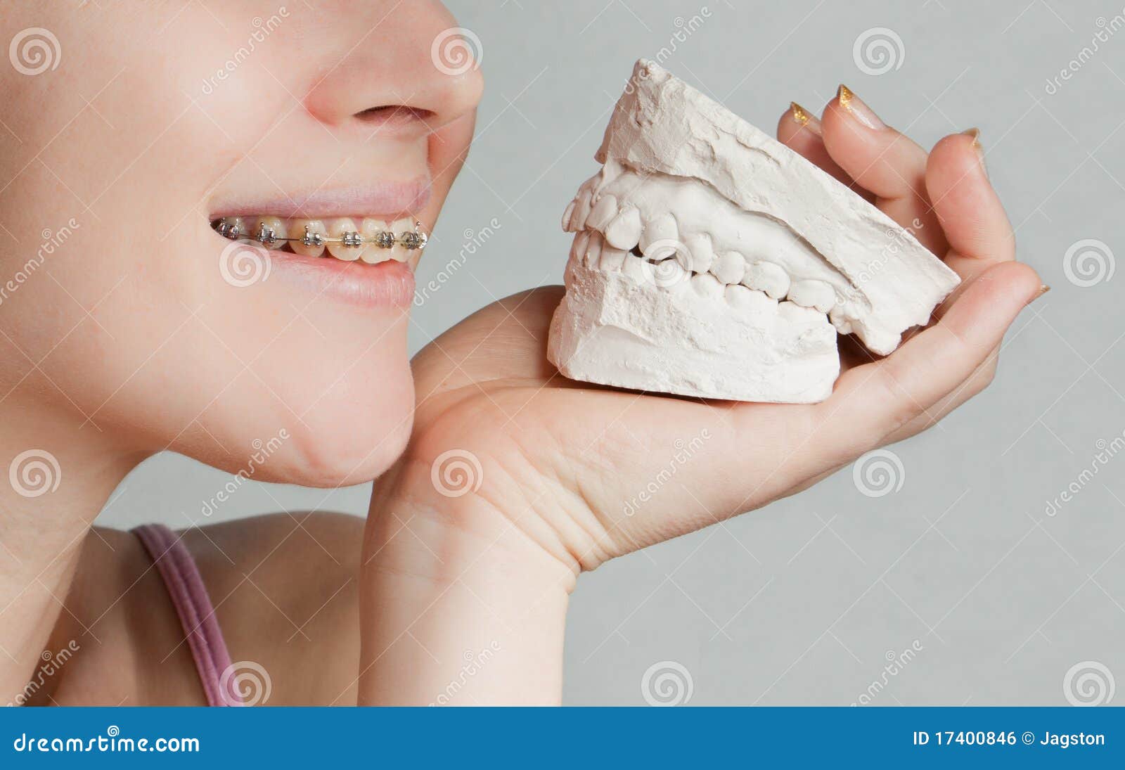 Smile with Bracket & Plaster Jaw Model Stock Photo - Image of ortho ...