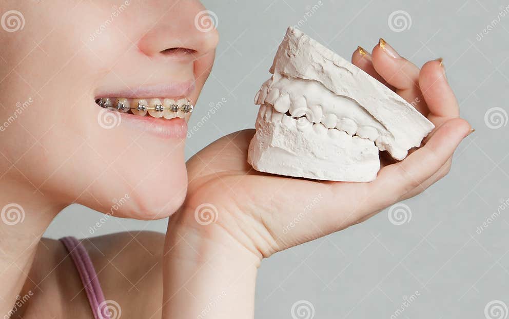 Smile with Bracket & Plaster Jaw Model Stock Photo - Image of ortho ...