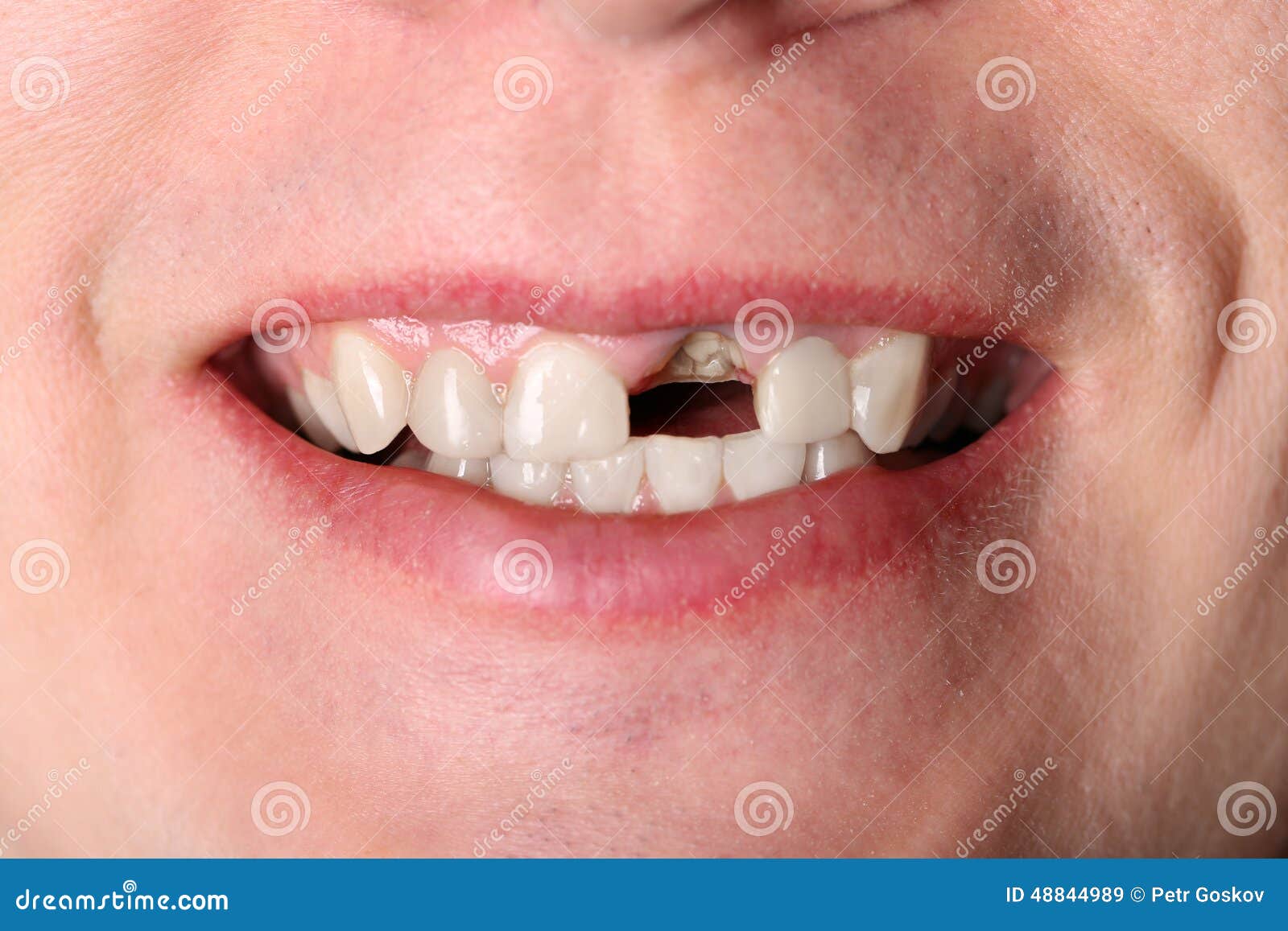 Smile without front tooth stock image. Image of mouth - 48844989
